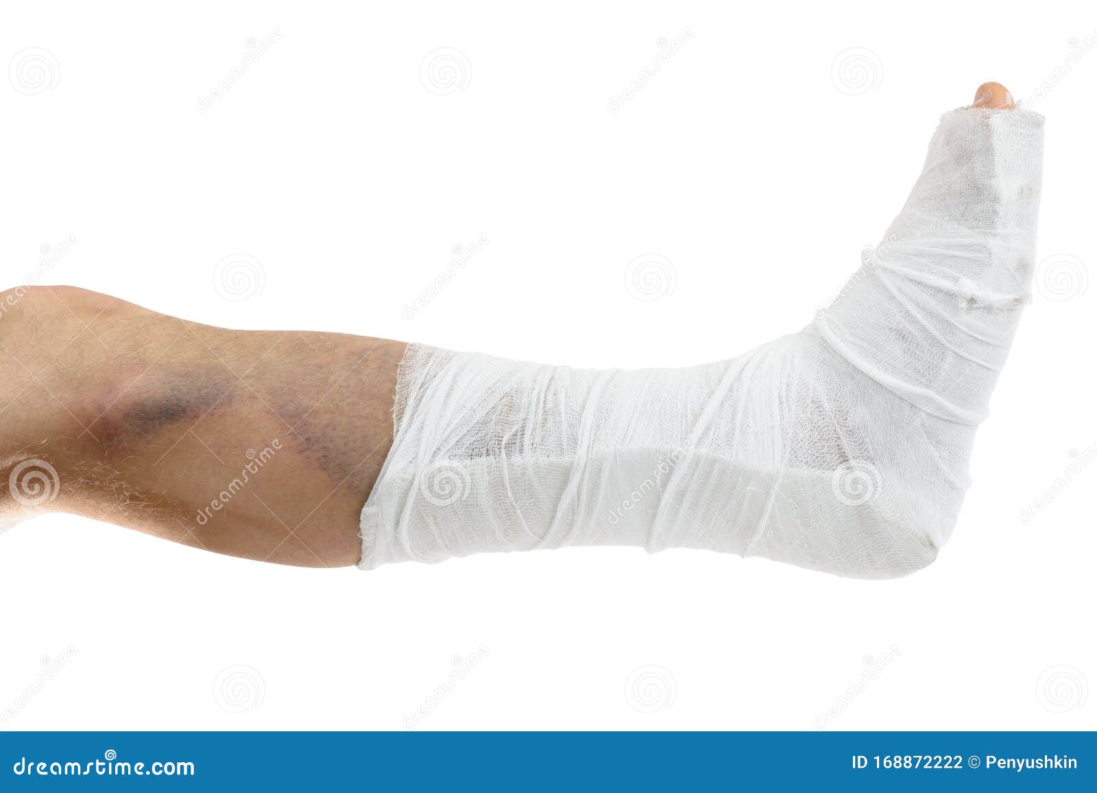 Broken leg in plaster. stock photo. Image of accident - 168872222