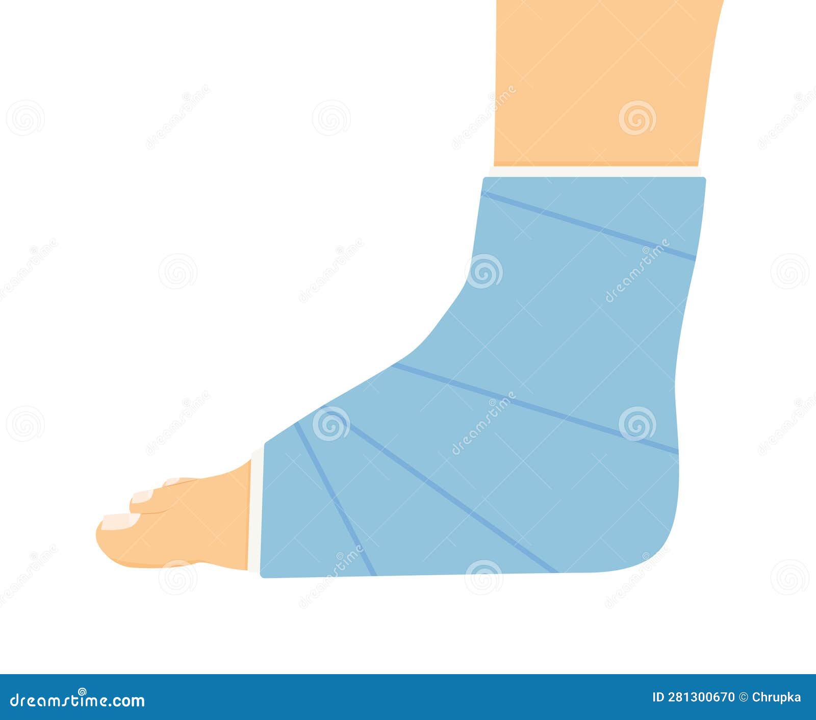 Broken leg with plaster stock vector. Illustration of male - 281300670