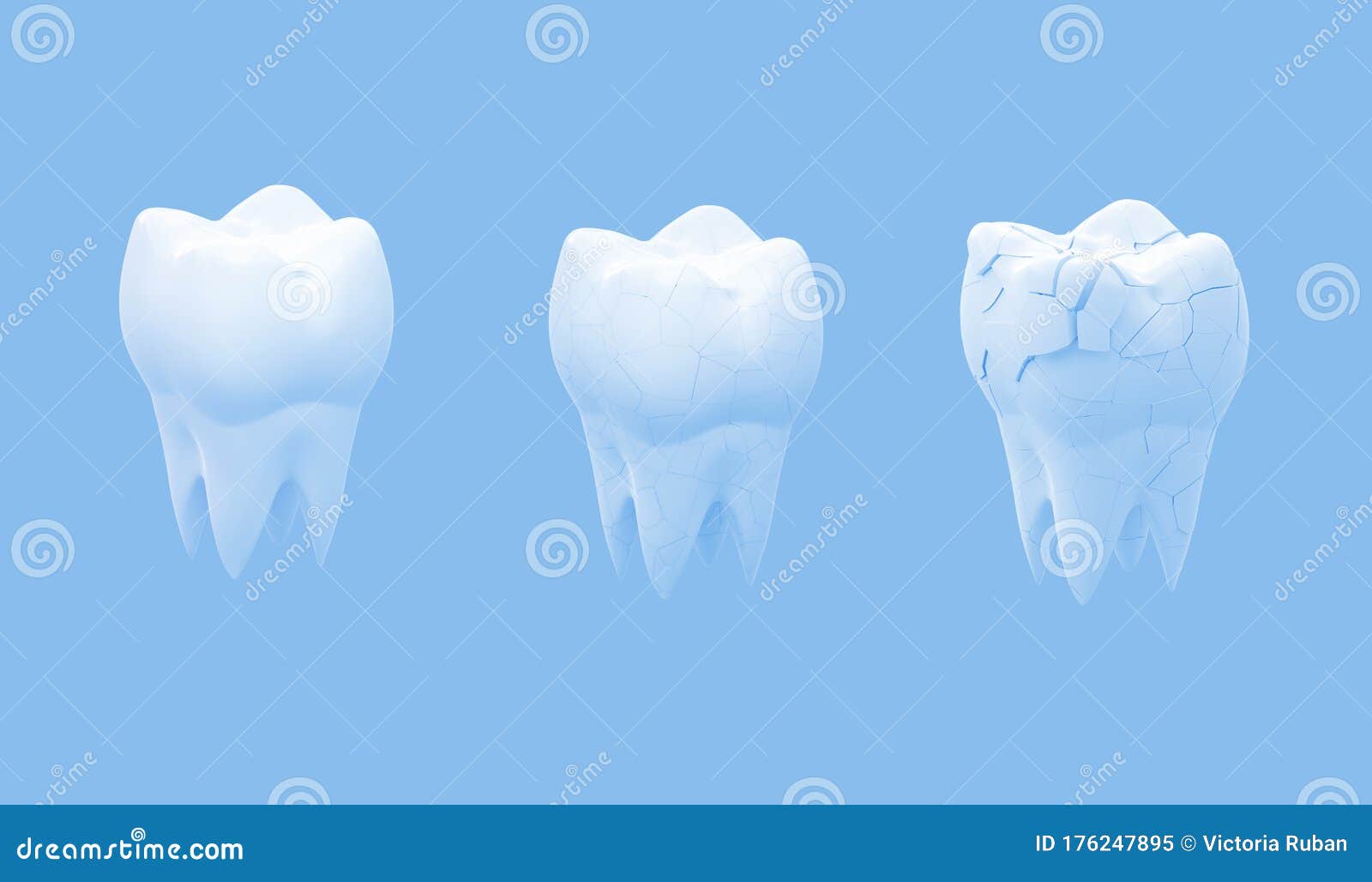 Broken Molars Tooth and Whole Tooth Isolated on Blue Background Stock ...