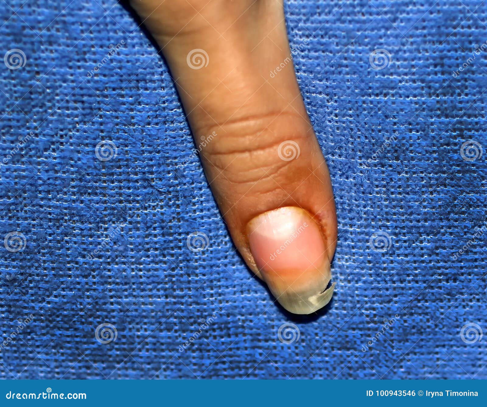 A Broken Nail. Lack of Vitamins and Calcium in the Body. Stock Photo ...