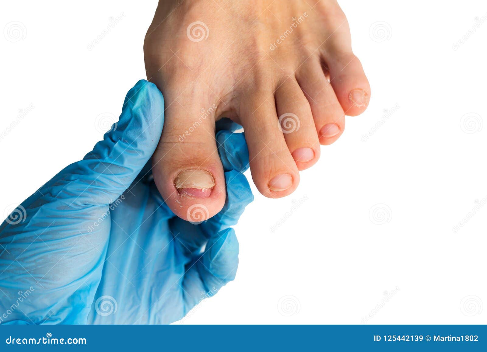 Broken nail on the leg stock image. Image of itraconazole - 125442139