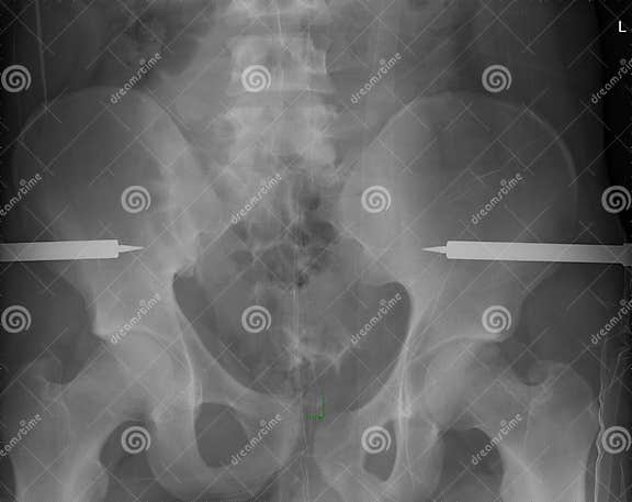 Broken pelvis stock photo. Image of hips, diagnostic - 12884690