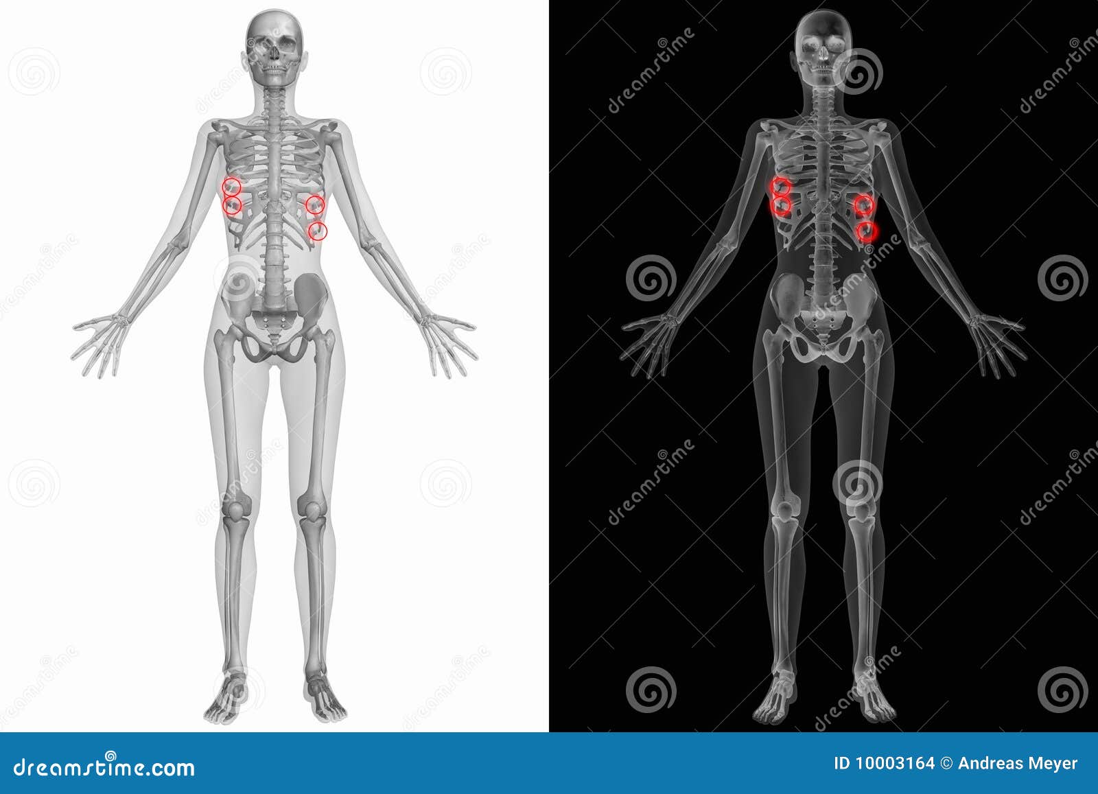 Broken Ribs stock illustration. Illustration of arms - 10003164