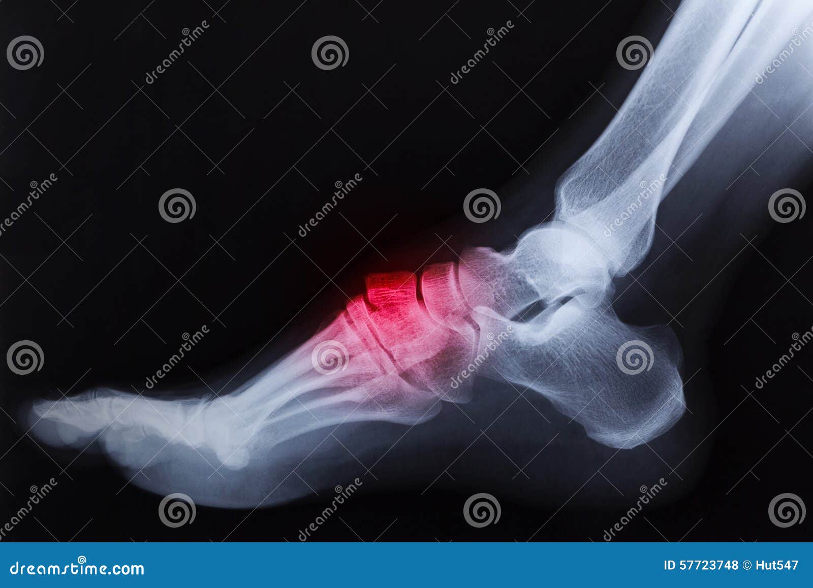 Broken Right Foot Ankle Xray Stock Photo - Image: 57723748