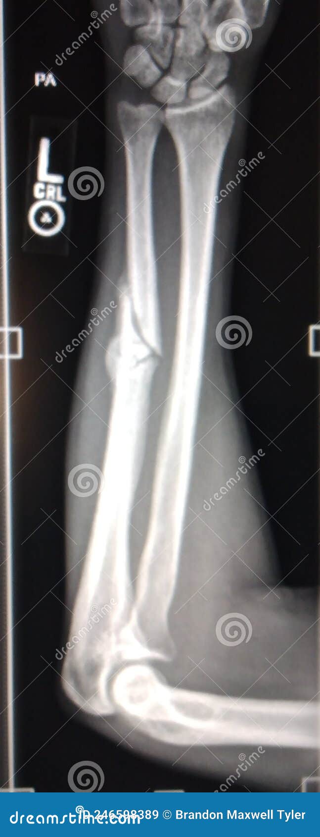 Broken Right Forearm stock image. Image of limb, right - 246598389