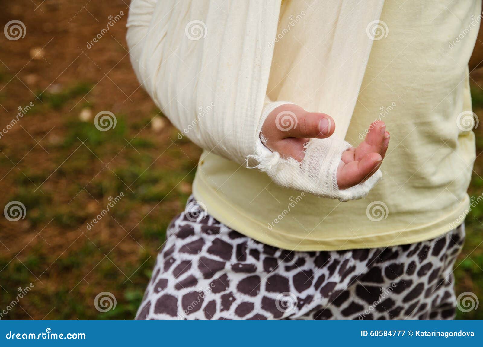 Broken shoulder in gyps stock image. Image of brave, child - 60584777