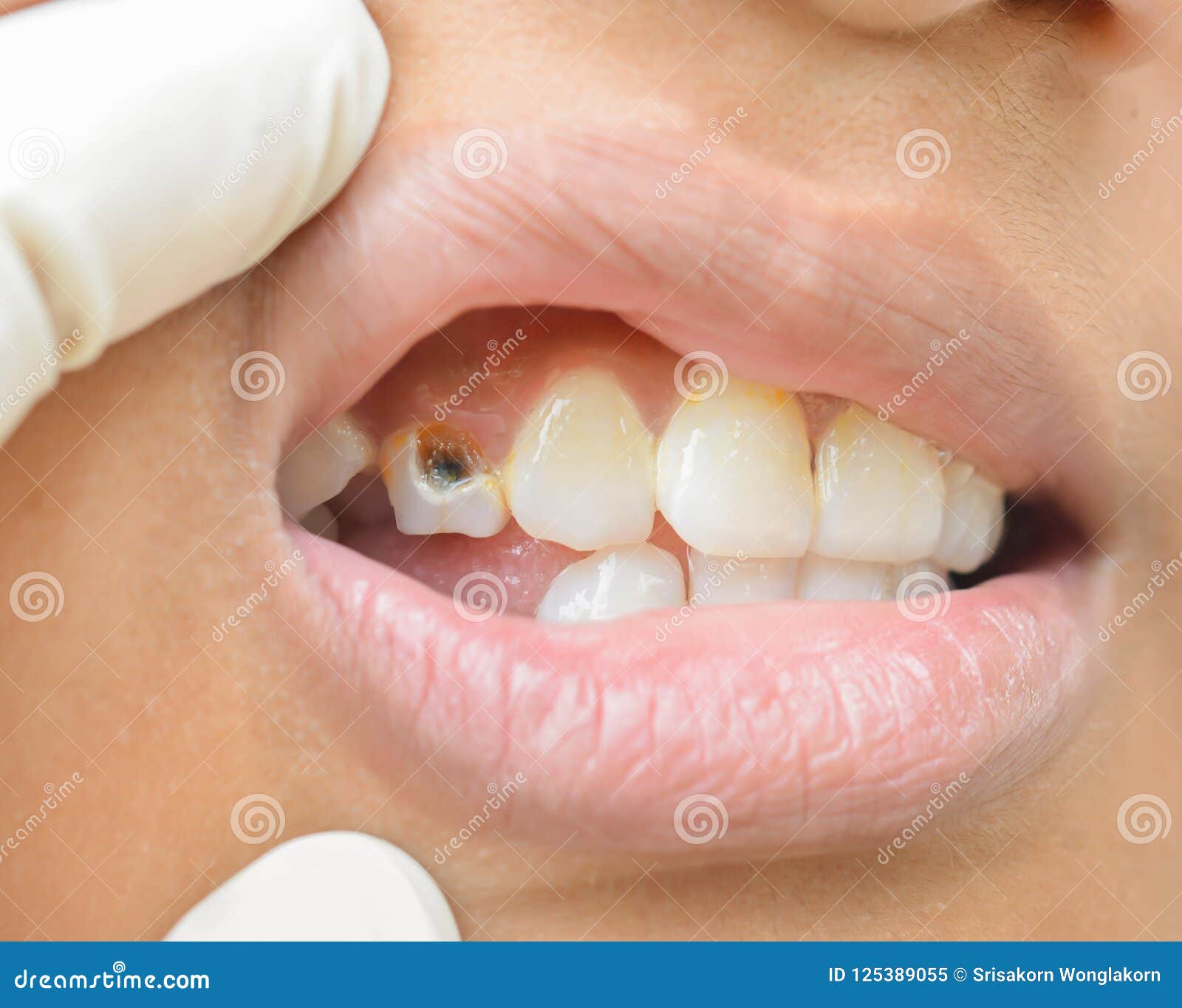Broken teeth in children stock image. Image of health - 125389055