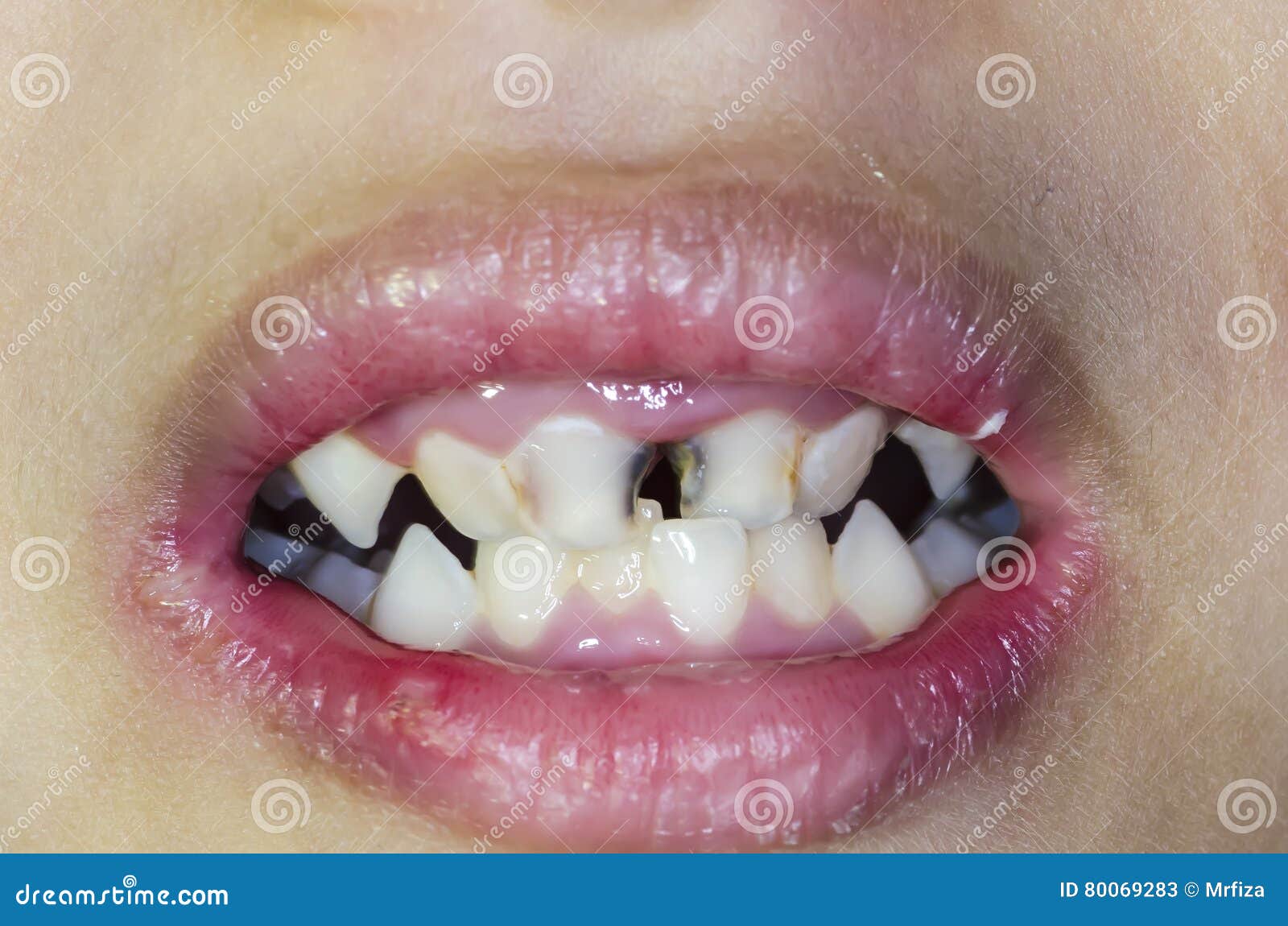 Broken teeth stock image. Image of human, close, clinic - 80069283