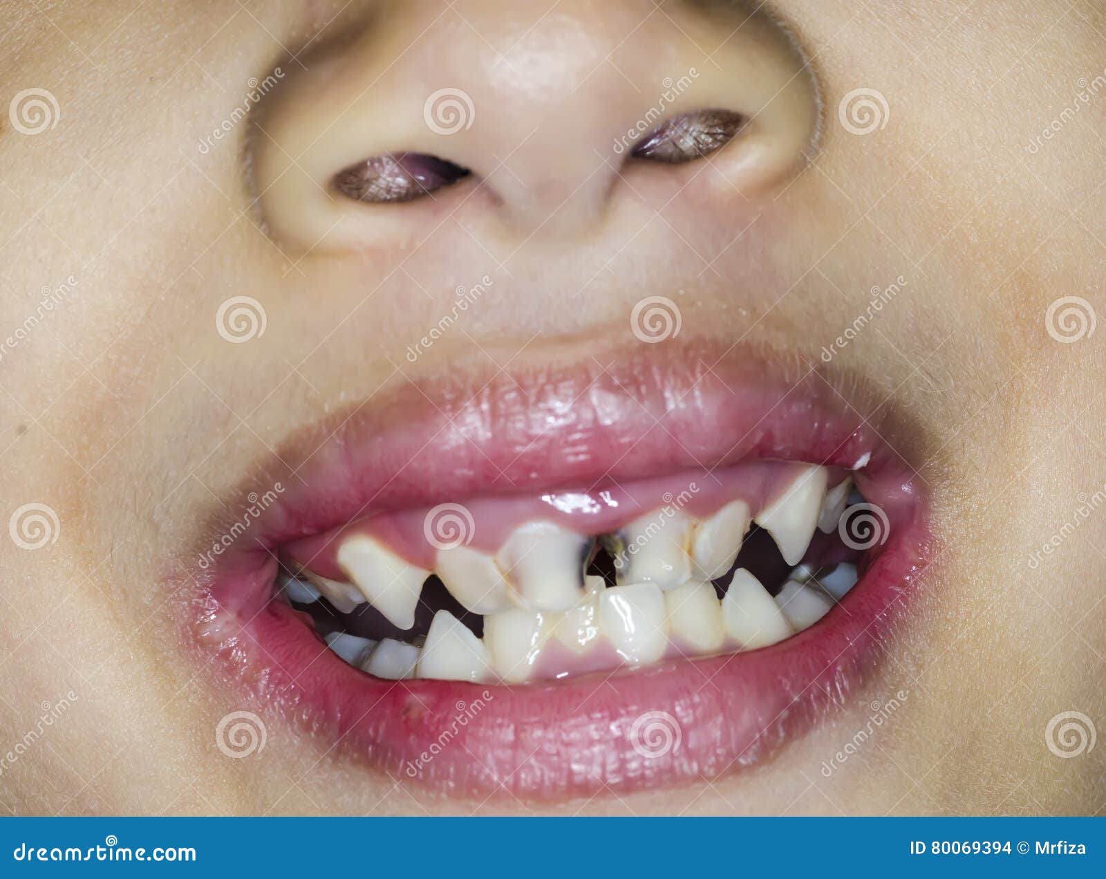 Broken teeth stock photo. Image of clinic, dentist, caries - 80069394