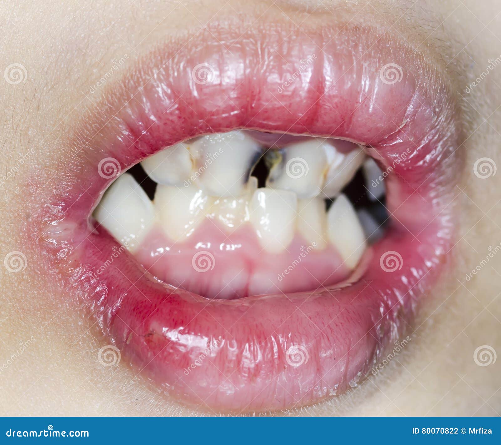 Broken teeth stock photo. Image of human, dental, losing - 80070822