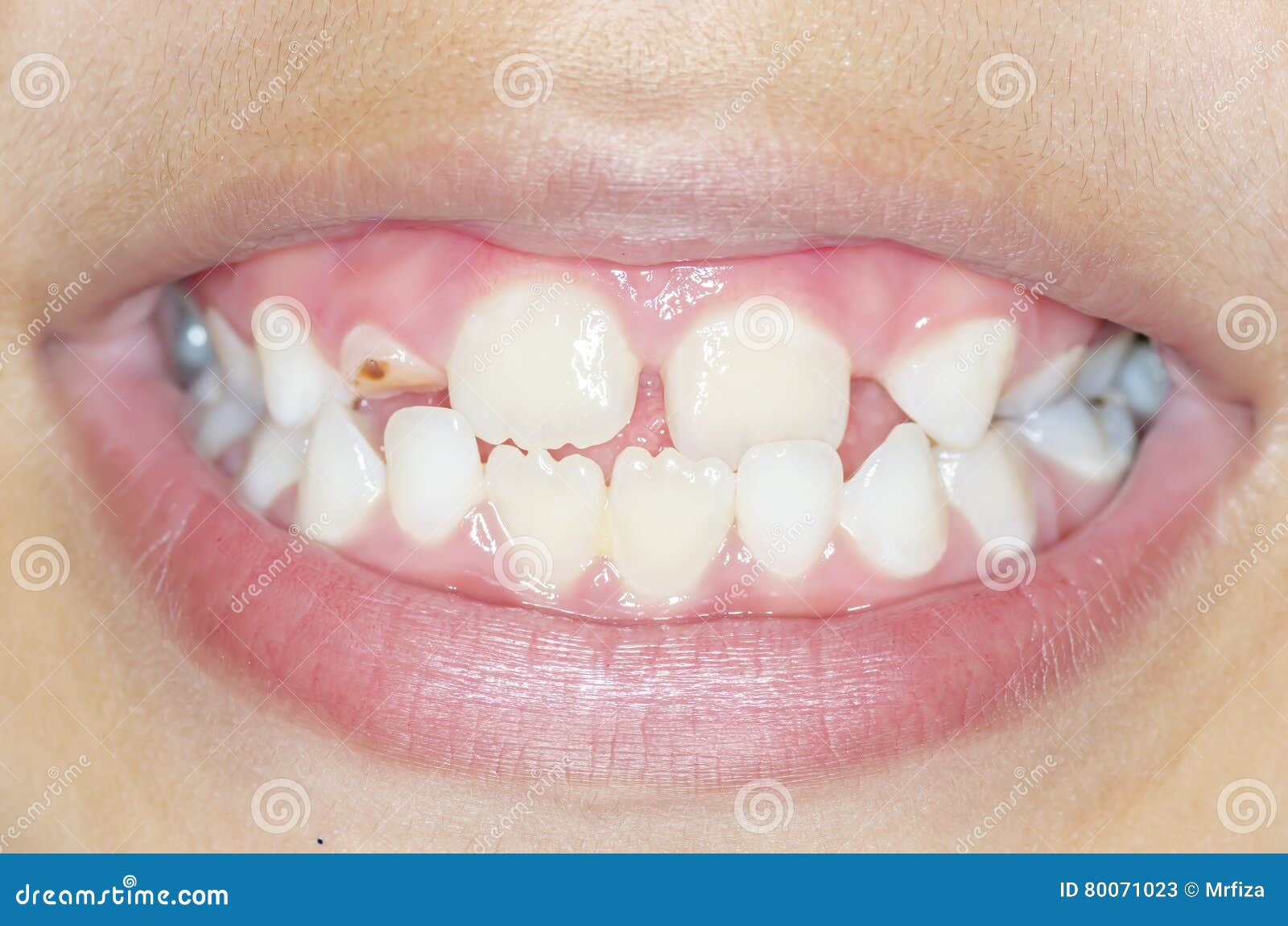 Broken teeth stock image. Image of broken, decay, dermatology - 80071023