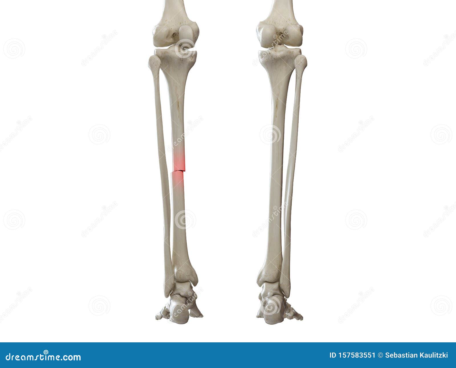 A Broken Tibia Stock Illustration | CartoonDealer.com #157583551