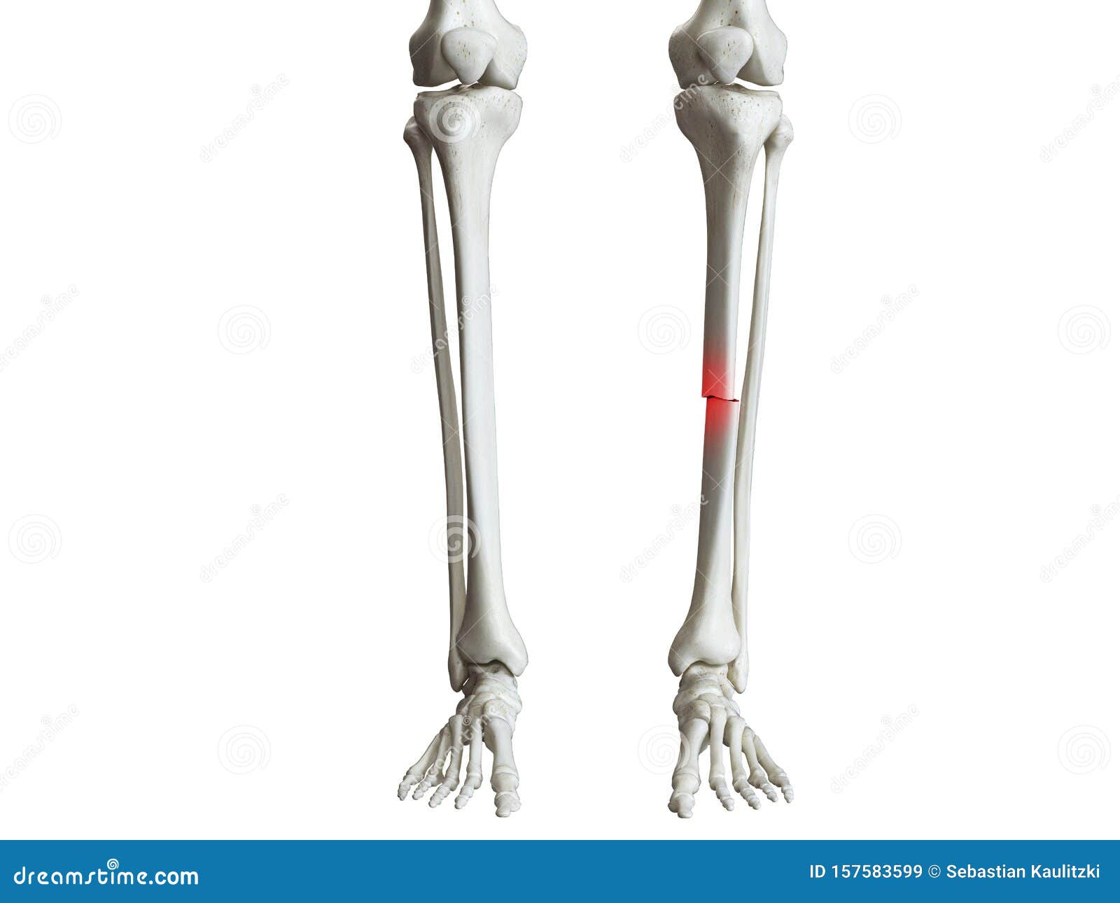 A broken tibia stock illustration. Illustration of biology - 157583599