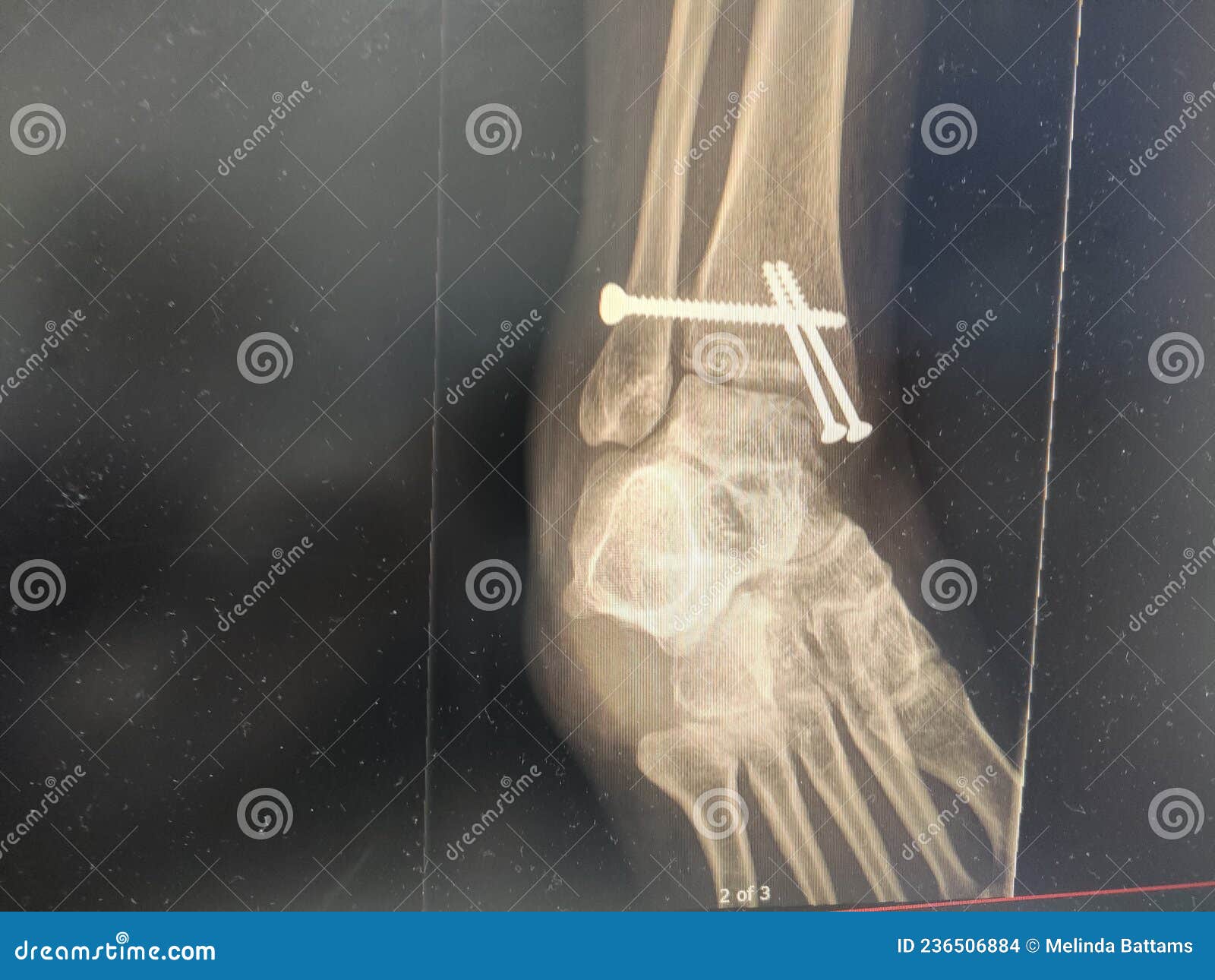Broken Tibia X-ray stock photo. Image of black, darkness - 236506884