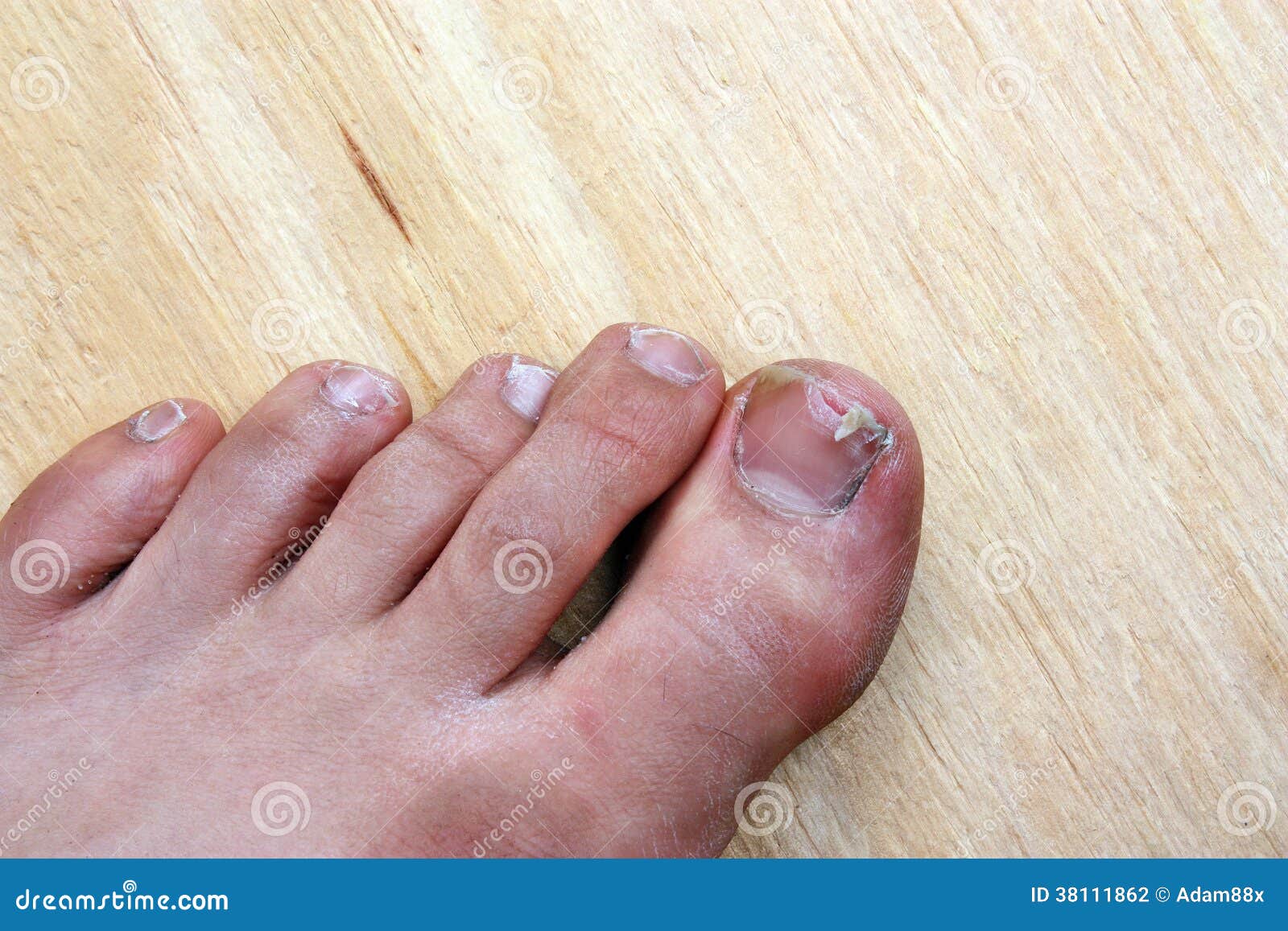 Broken toenail stock photo. Image of macro, disease, foot - 38111862