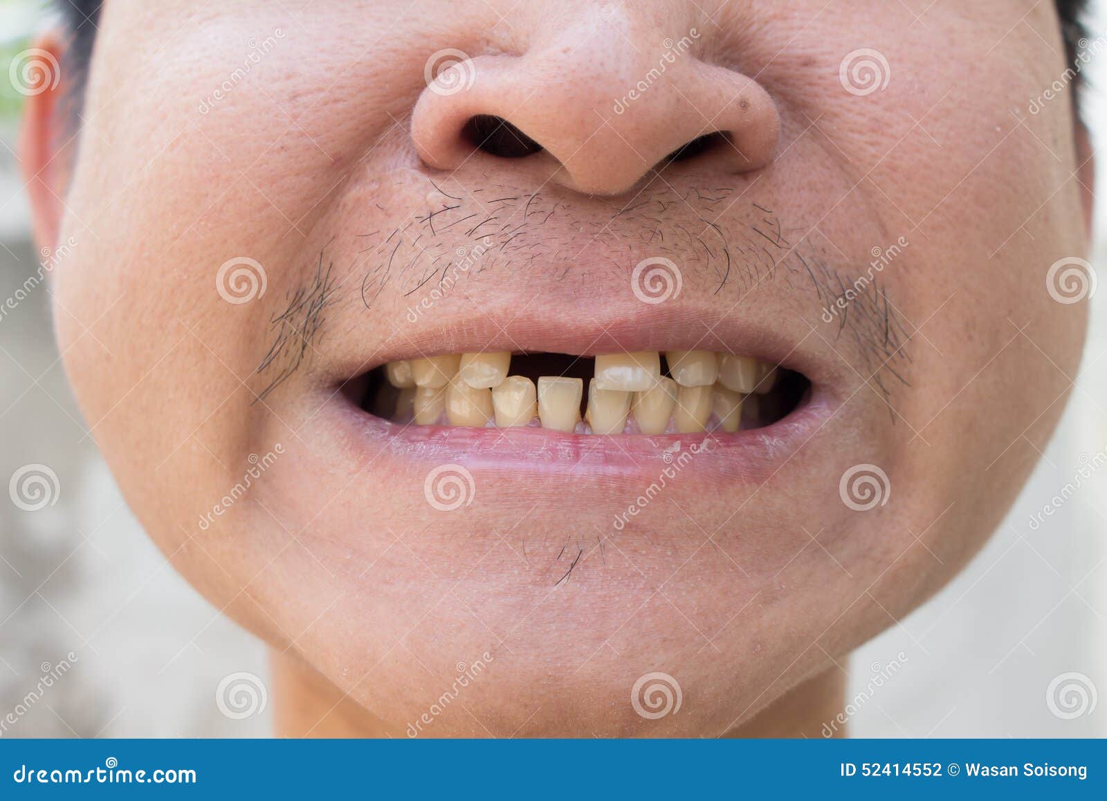 Broken Tooth Removal With Dental Caries On White Stock Photo ...