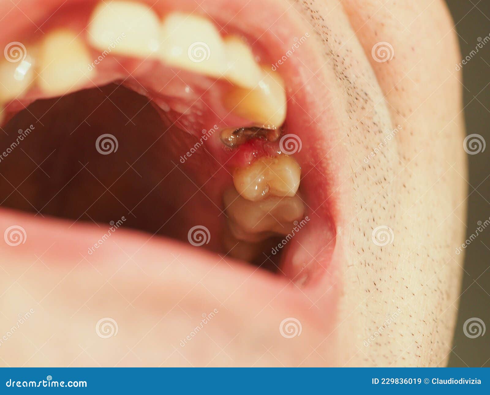 Broken Tooth with only Root Remaining Stock Image - Image of canal ...