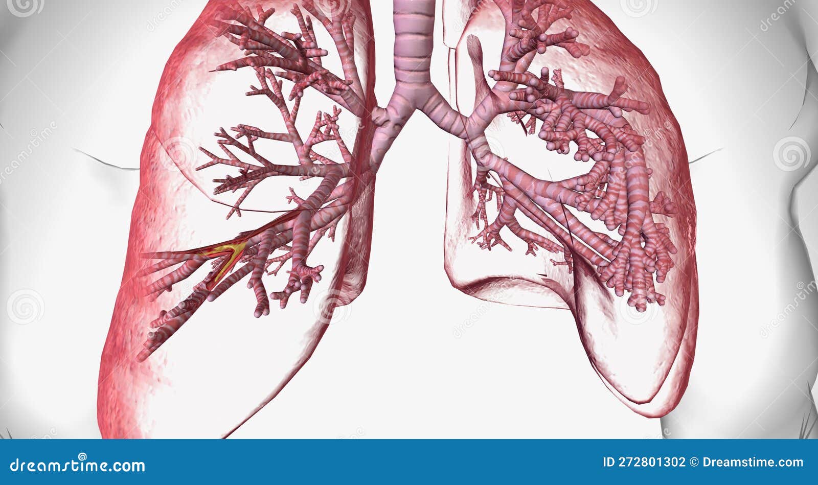 Bronchiectasis, Affecting the Lungs, Characterized by Inflamed Airways ...