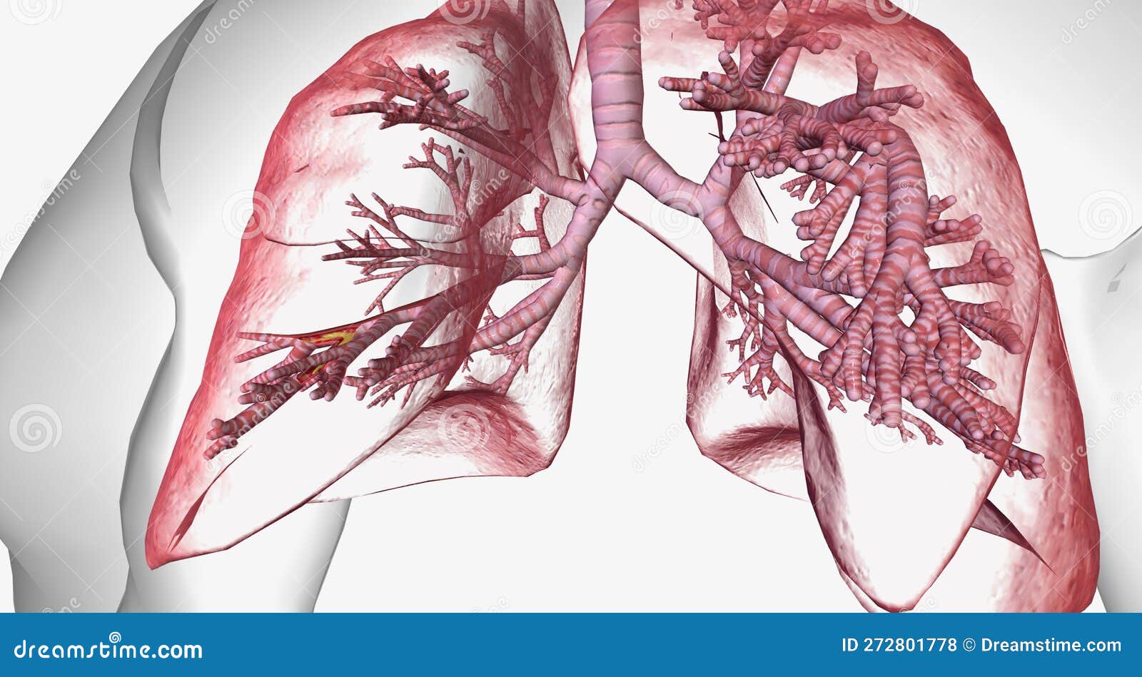 Bronchiectasis Affecting The Lungs Characterized By Inflamed Airways Excessive Mucus And