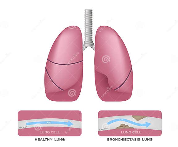 Bronchiectasis in Lung Infographic Stock Vector - Illustration of ...