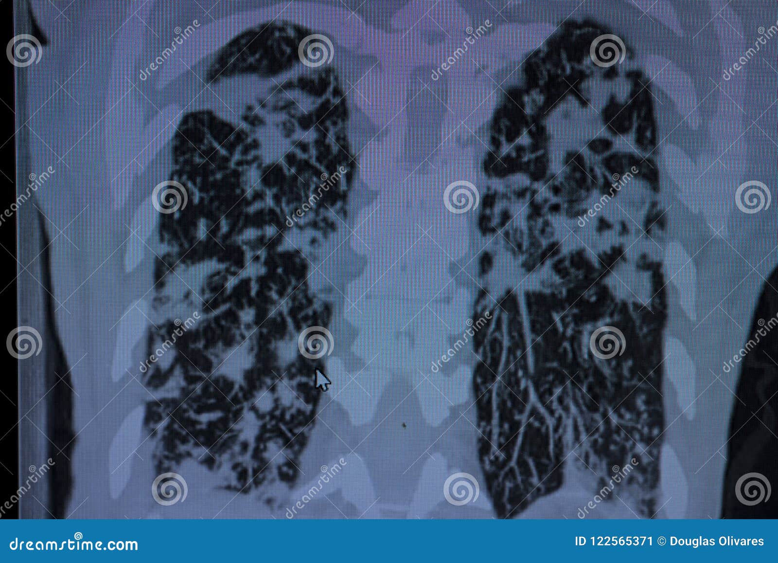 Bronchiectasis and Pulmonary TB Stock Image - Image of business ...