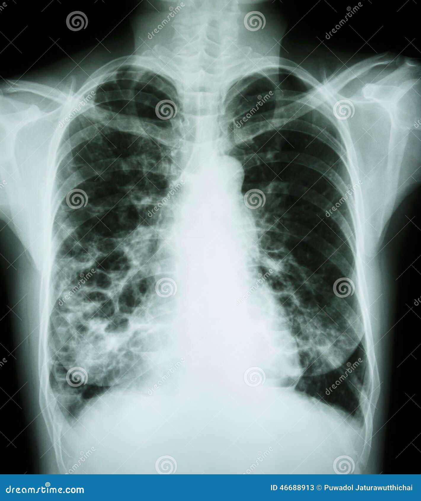 Bronchiectasis stock image. Image of chest, healthcare - 46688913