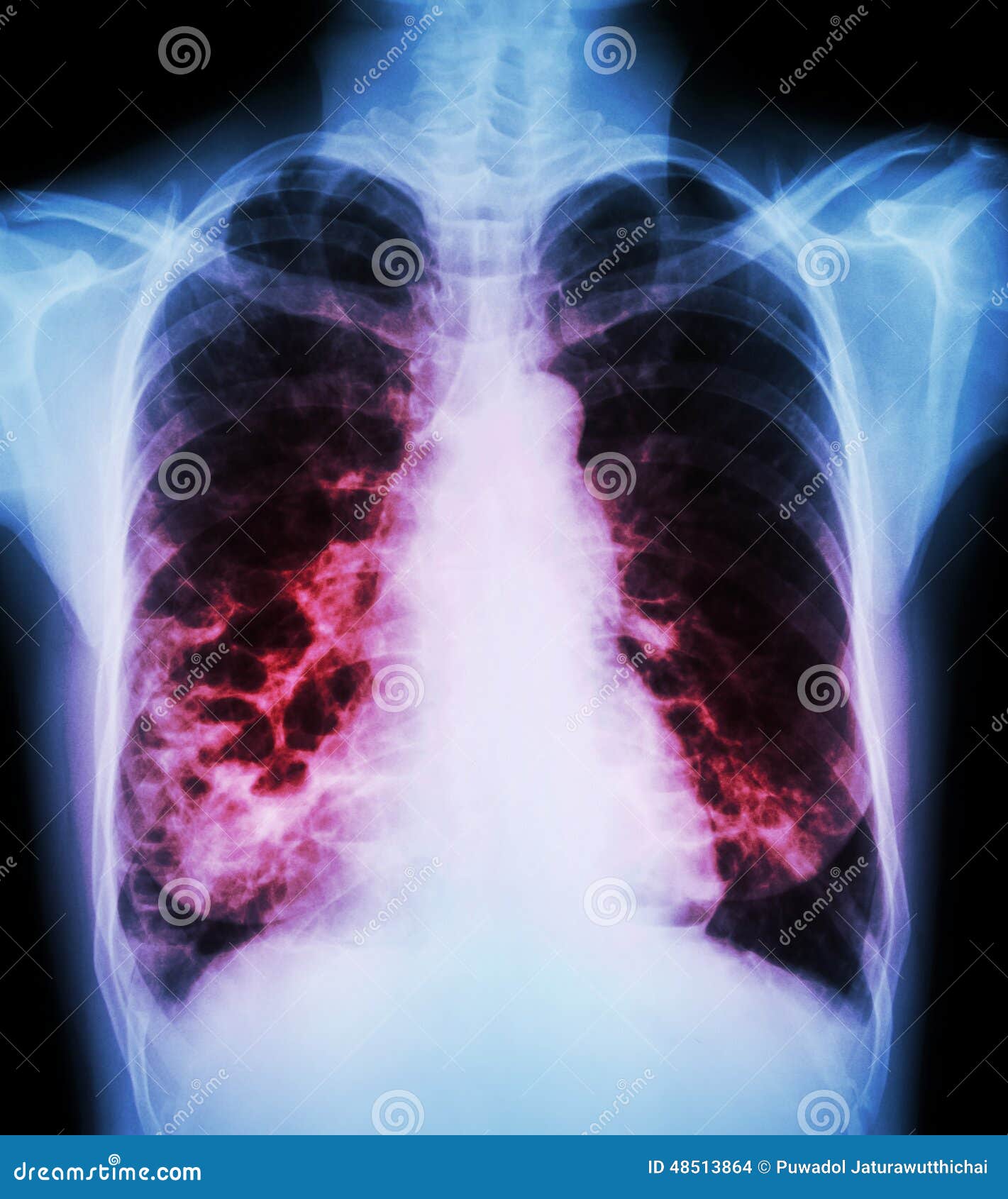 Bronchiectasis stock photo. Image of body, disease, chronic - 48513864