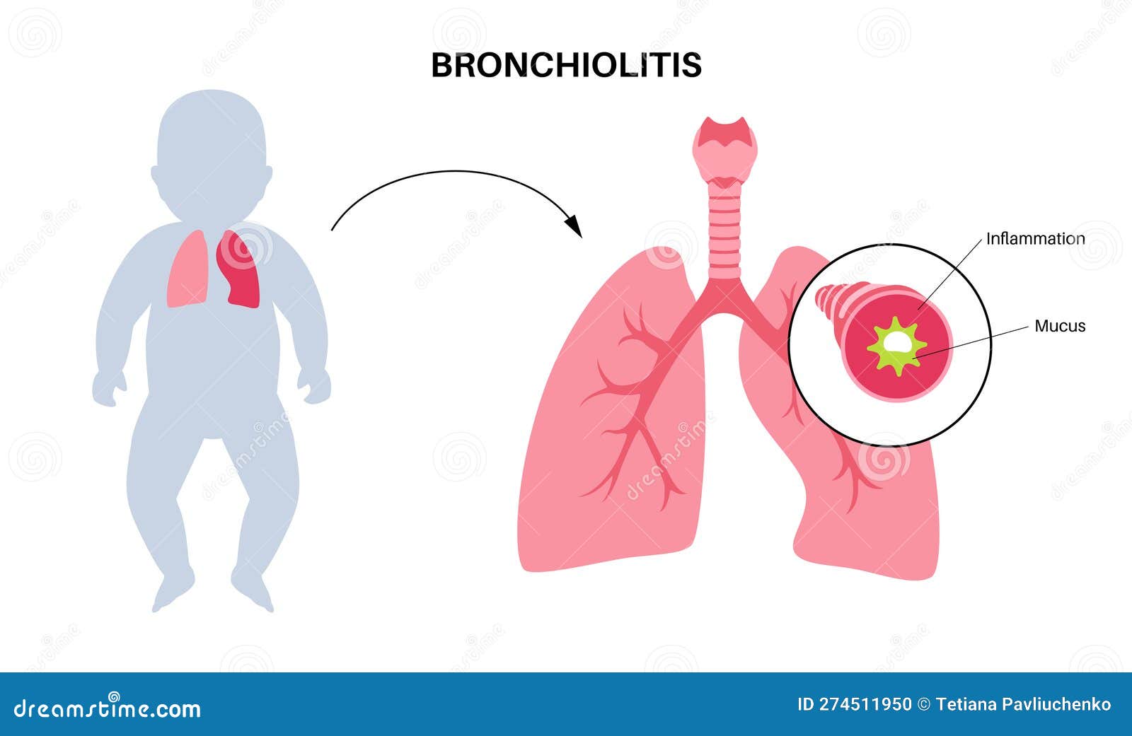 Bronchiolitis lung disease stock vector. Illustration of anatomy ...