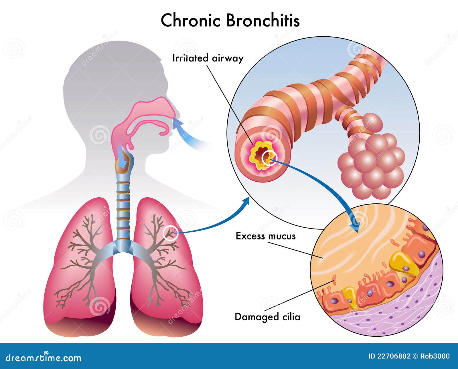 Bronchite Cronica Fotografia Stock - Immagine: 22706802