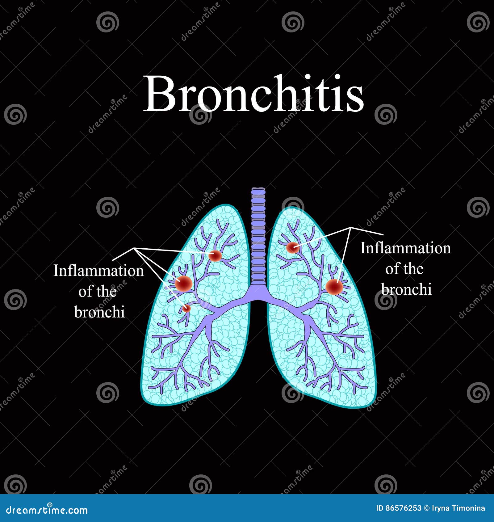 Bronchitis. the Anatomical Structure of the Human Lung Stock Vector ...