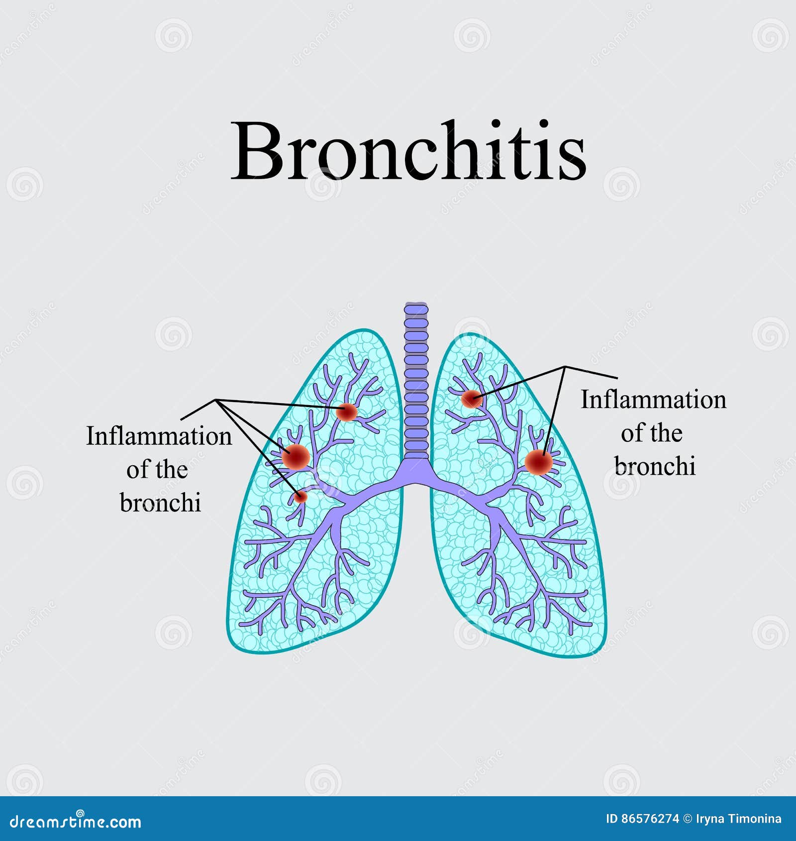 Bronchitis. The Anatomical Structure Of The Human Cartoon Vector ...