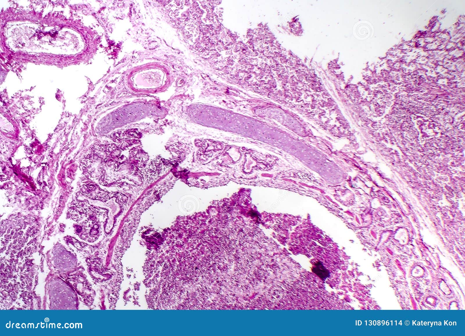 Bronchopneumonia, Light Micrograph Stock Photo - Image of bronchus ...