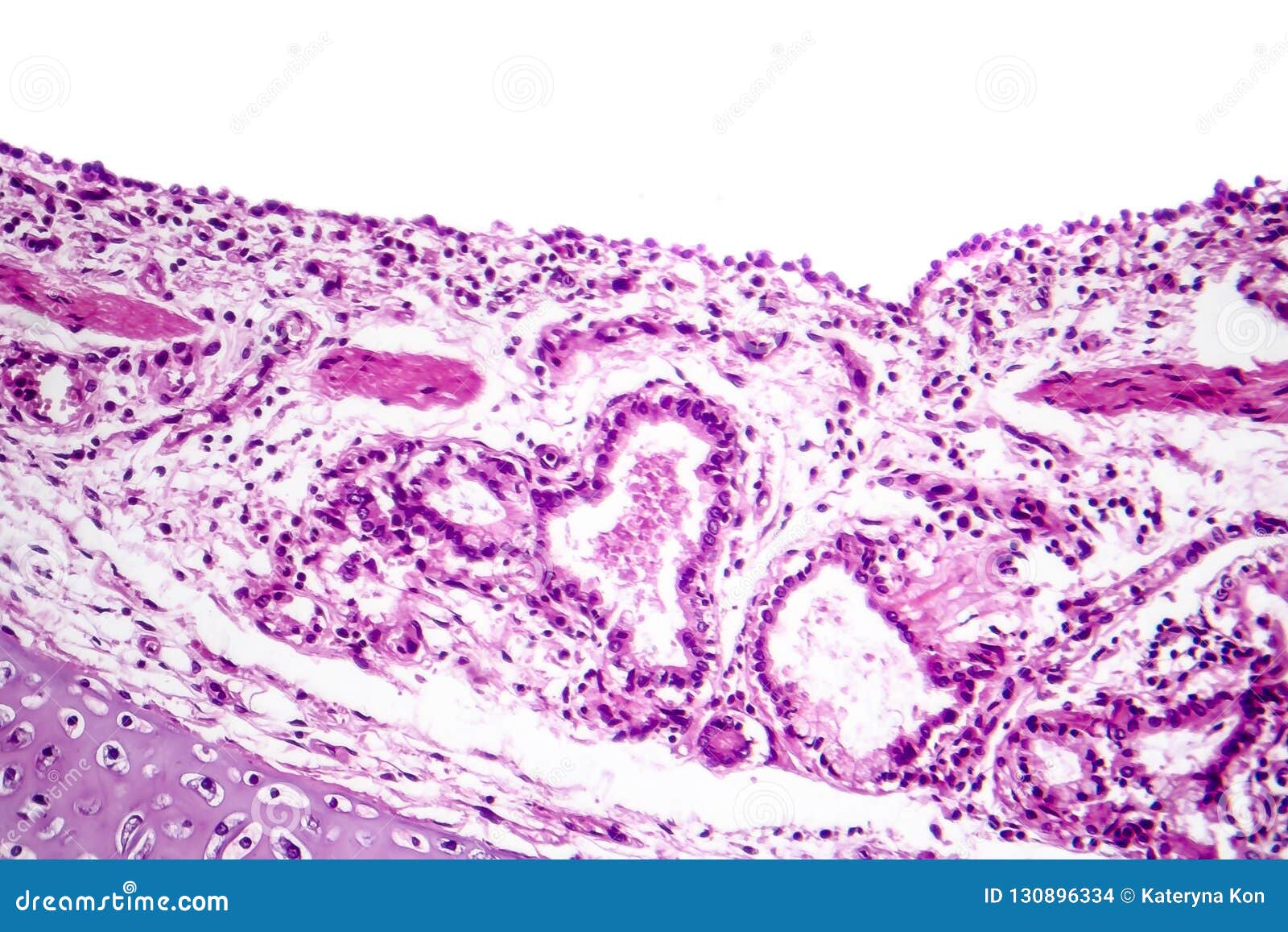 Bronchopneumonia, Light Micrograph Stock Photo - Image of micro ...