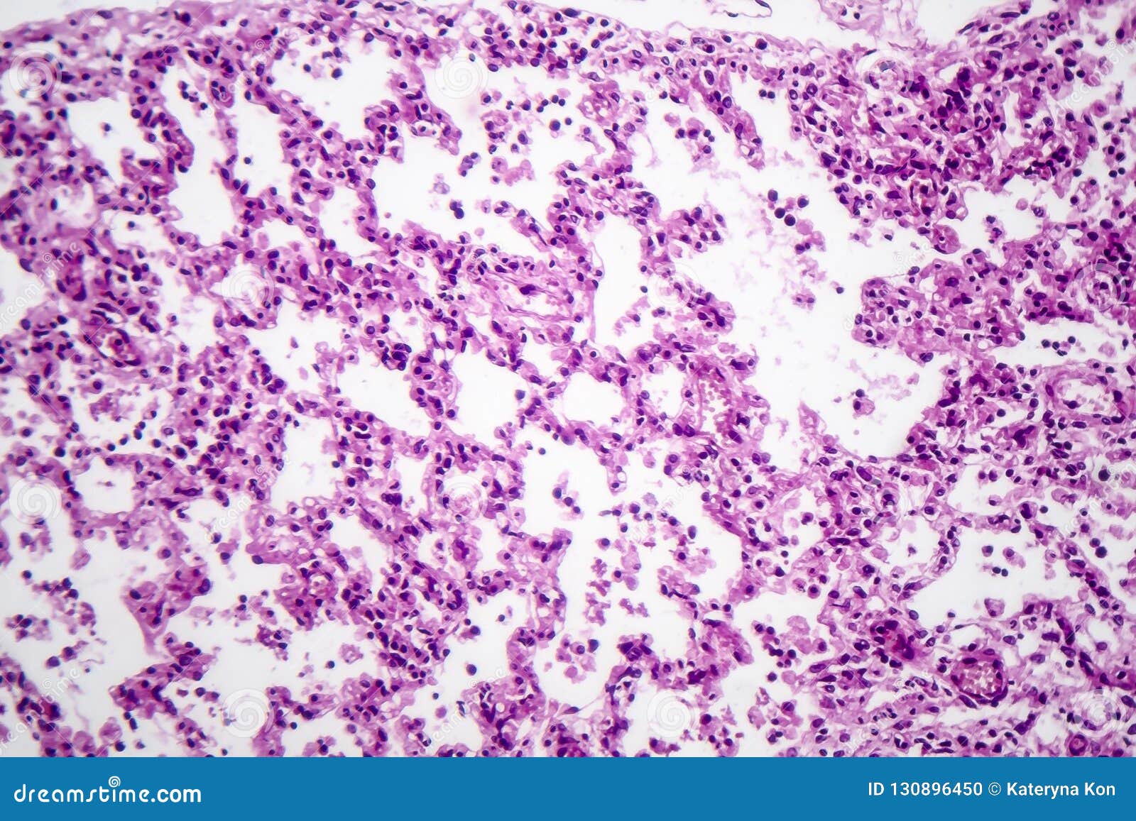 Bronchopneumonia, Light Micrograph Stock Photo - Image of ...