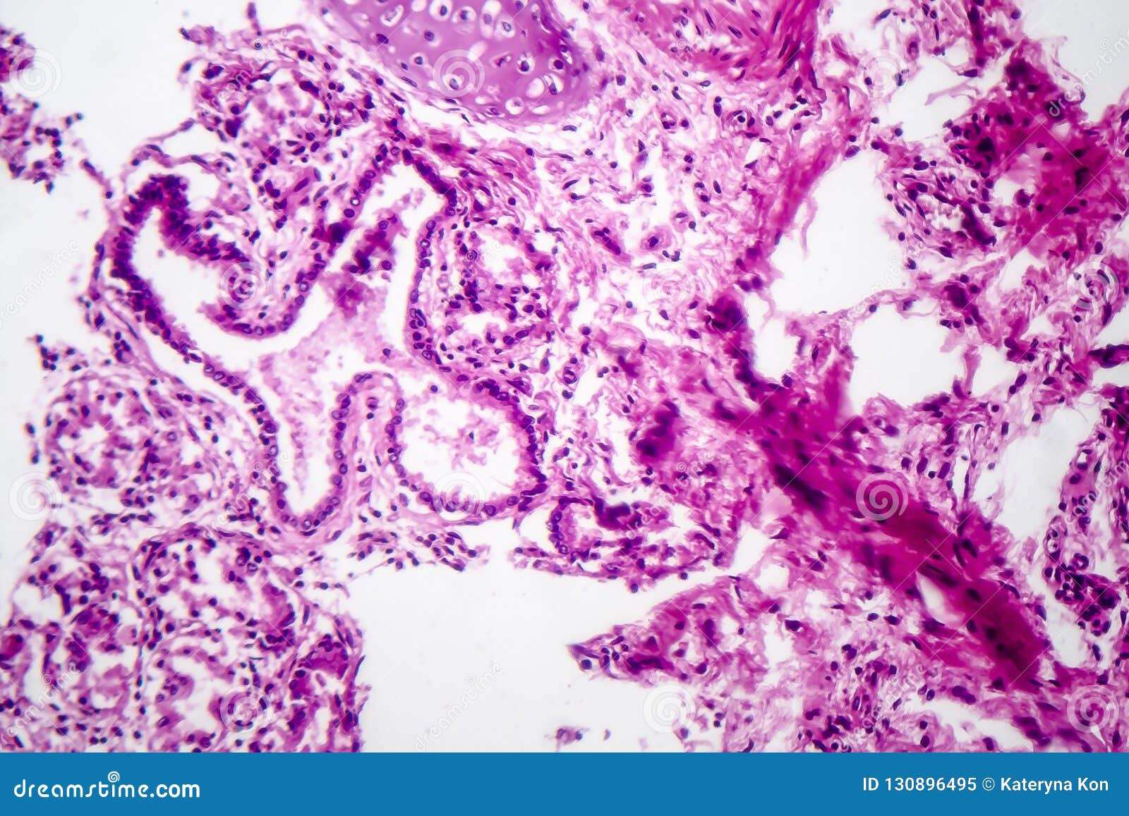 Bronchopneumonia, Light Micrograph Stock Image - Image of medicine ...