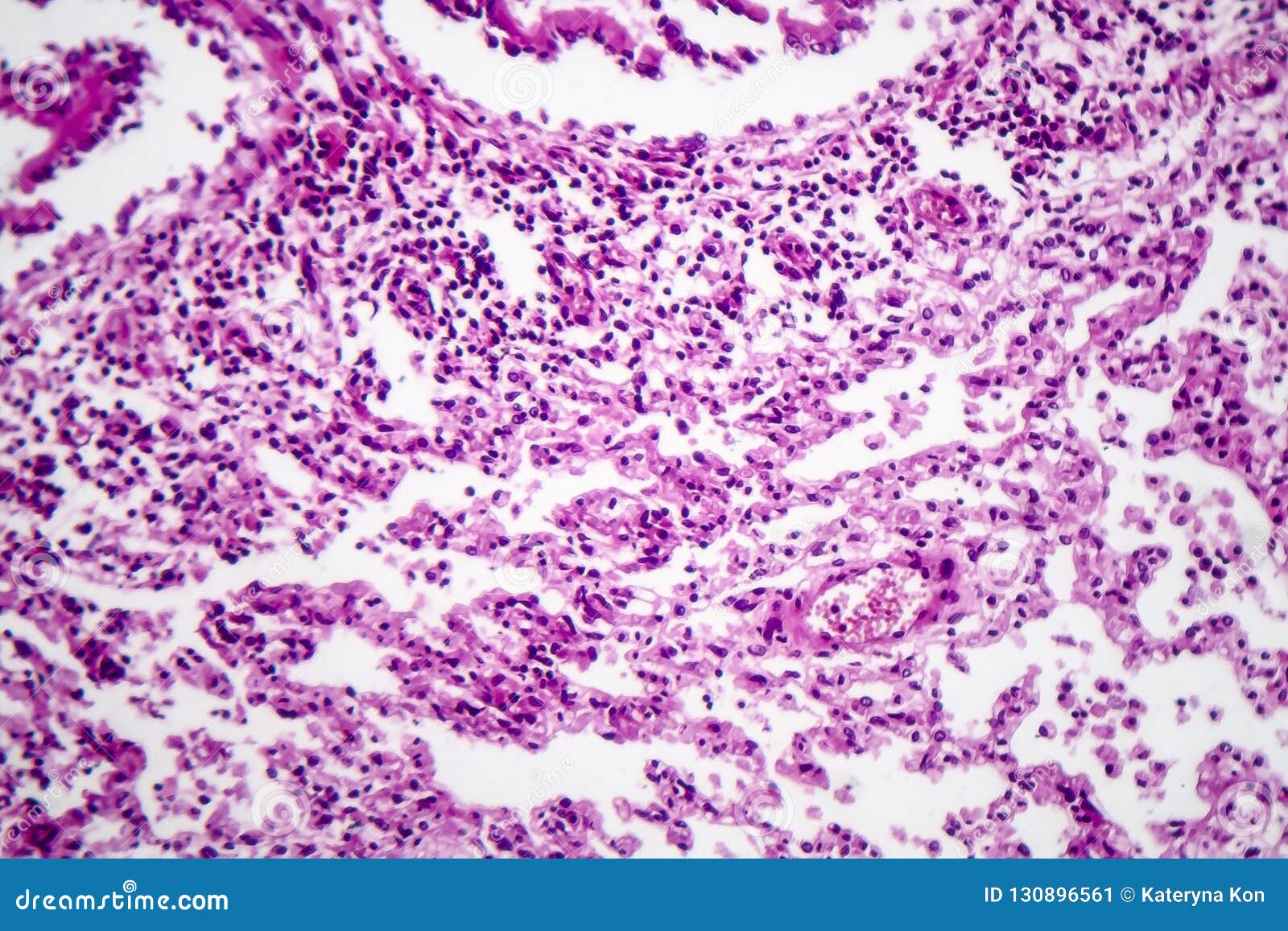 Bronchopneumonia, Light Micrograph Stock Image - Image of bronchitis ...