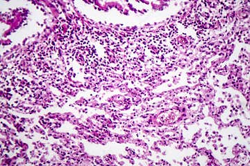 Bronchopneumonia, Light Micrograph Stock Image - Image of bronchitis ...