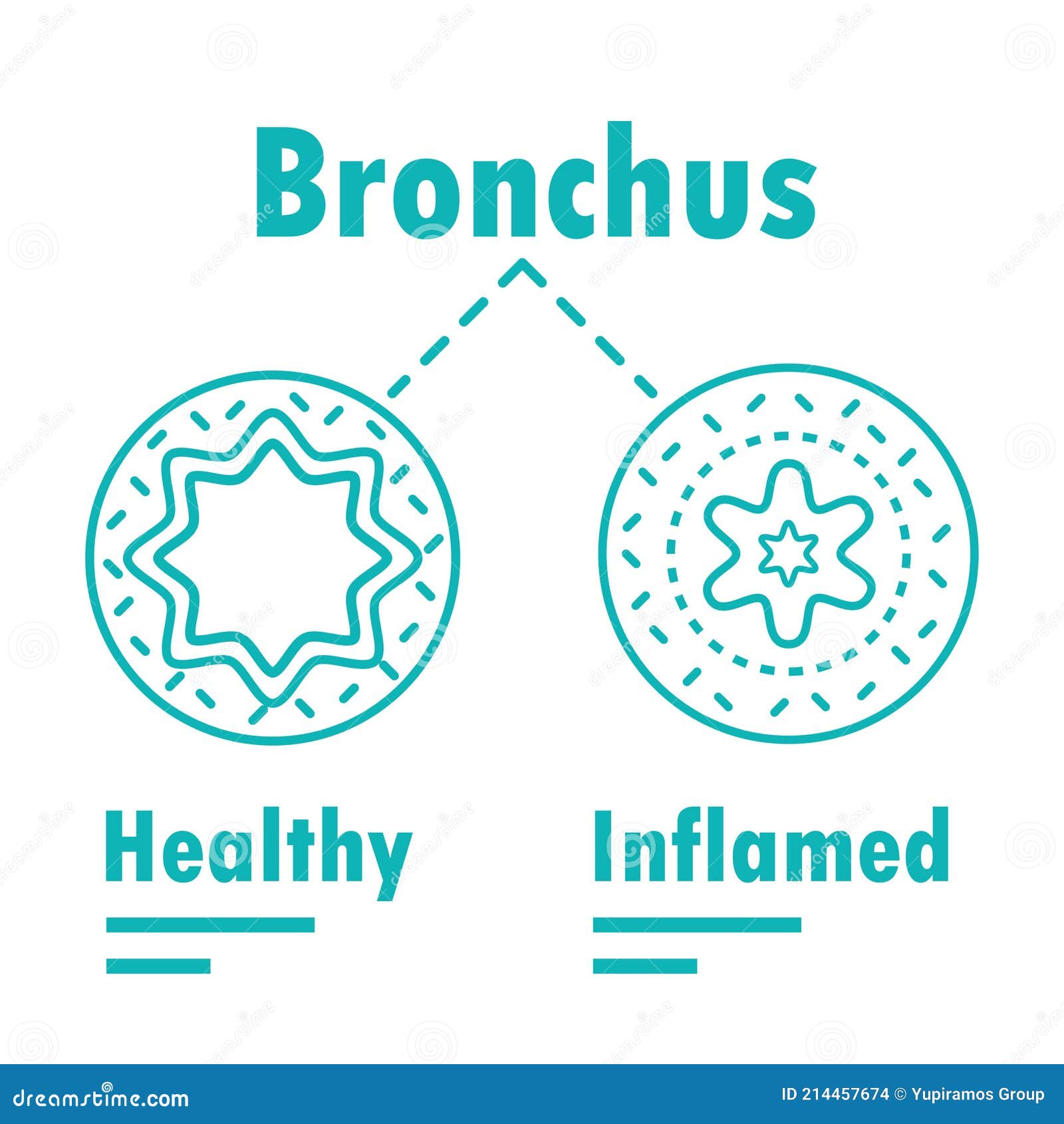 Bronchus Disease Infographic Vector Illustration | CartoonDealer.com ...