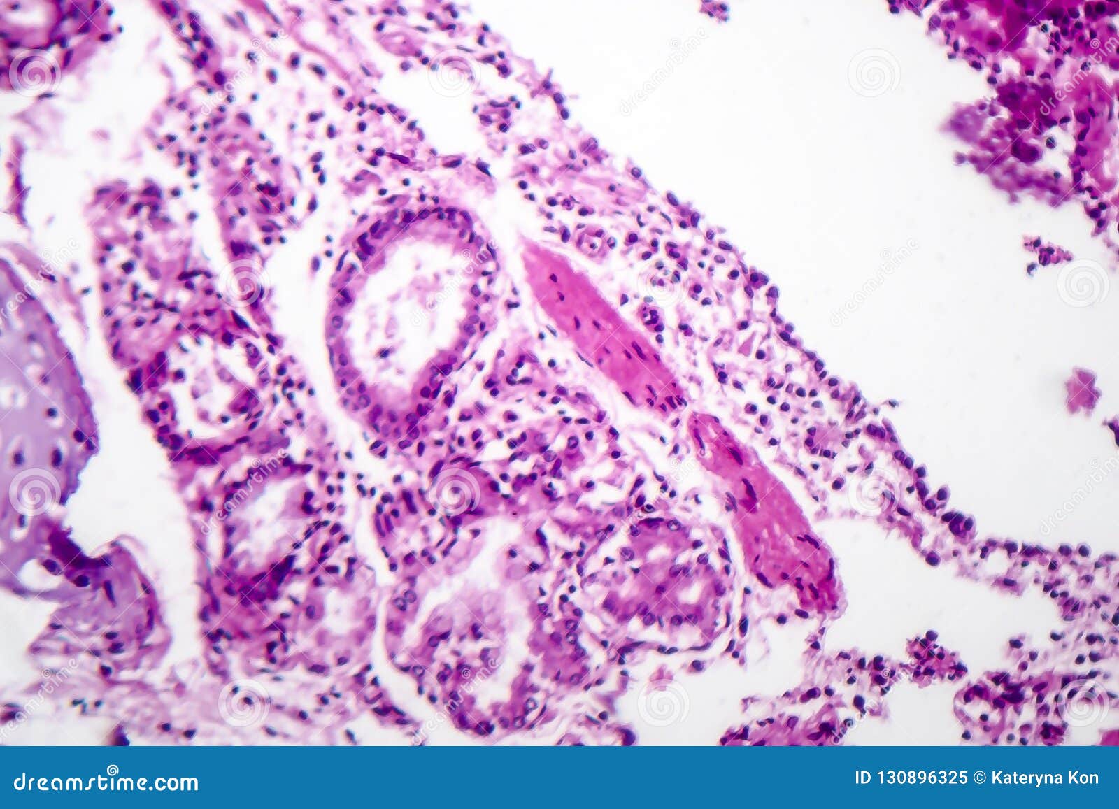 Broncopneumonia, Micrografia Leve Imagem de Stock - Imagem de micro ...
