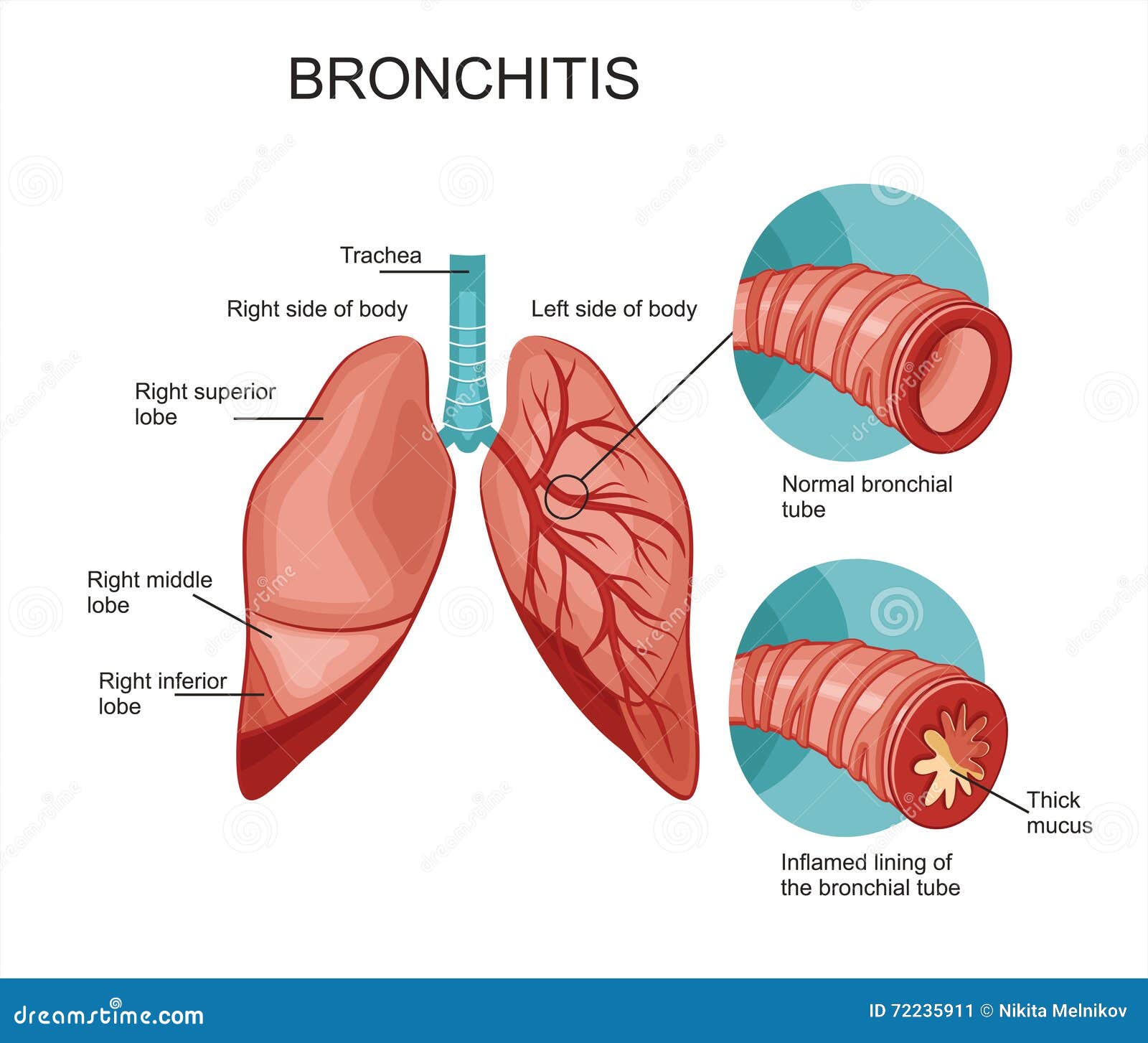 Bronquitis ilustración del vector. Ilustración de enfermedad - 72235911