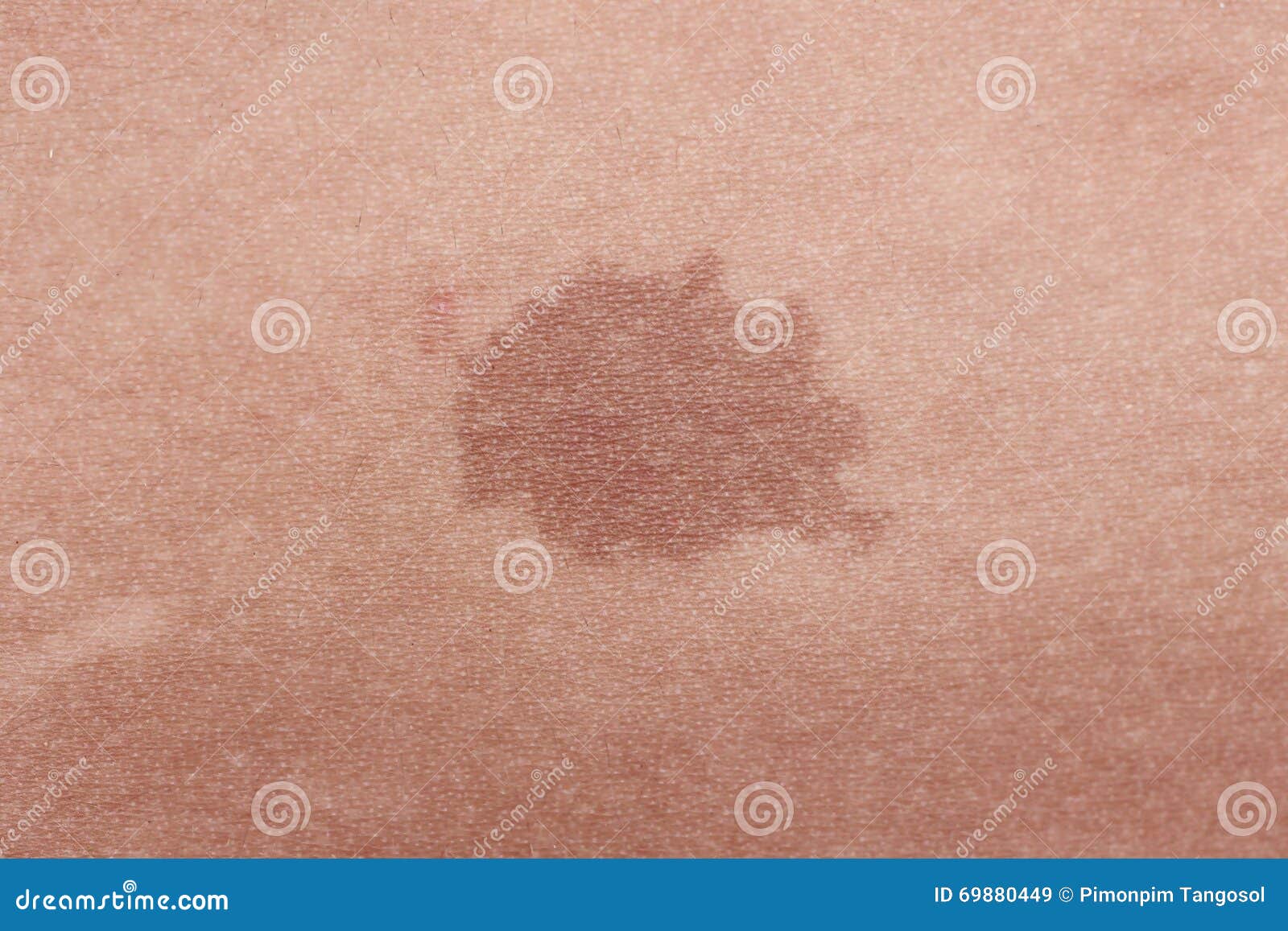 Brown-Muttermal stockbild. Bild von verletzungen, krebs - 69880449