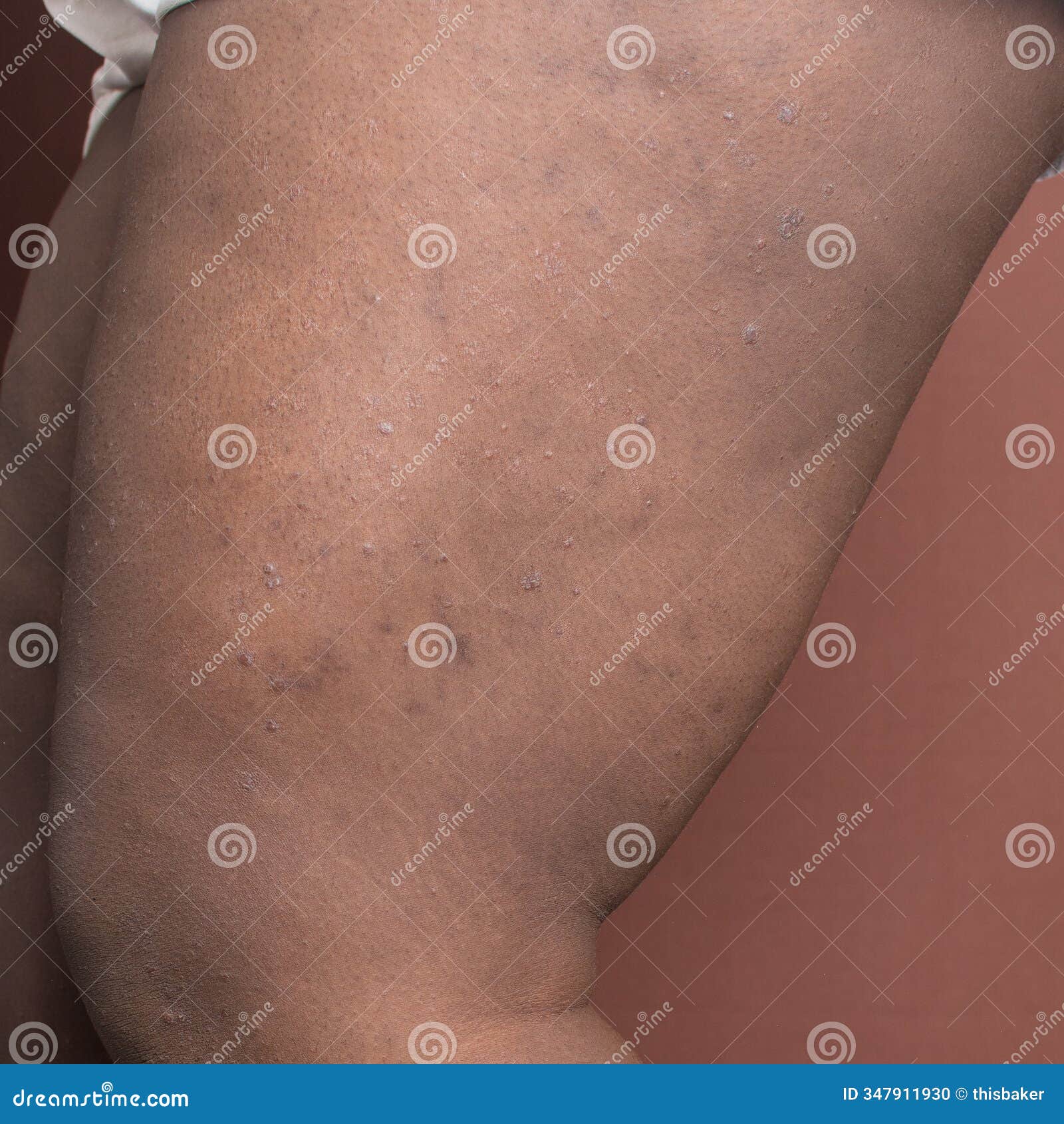 Brown Skin with Hyperpigmentation and Scarring from Eczema and Atopic ...