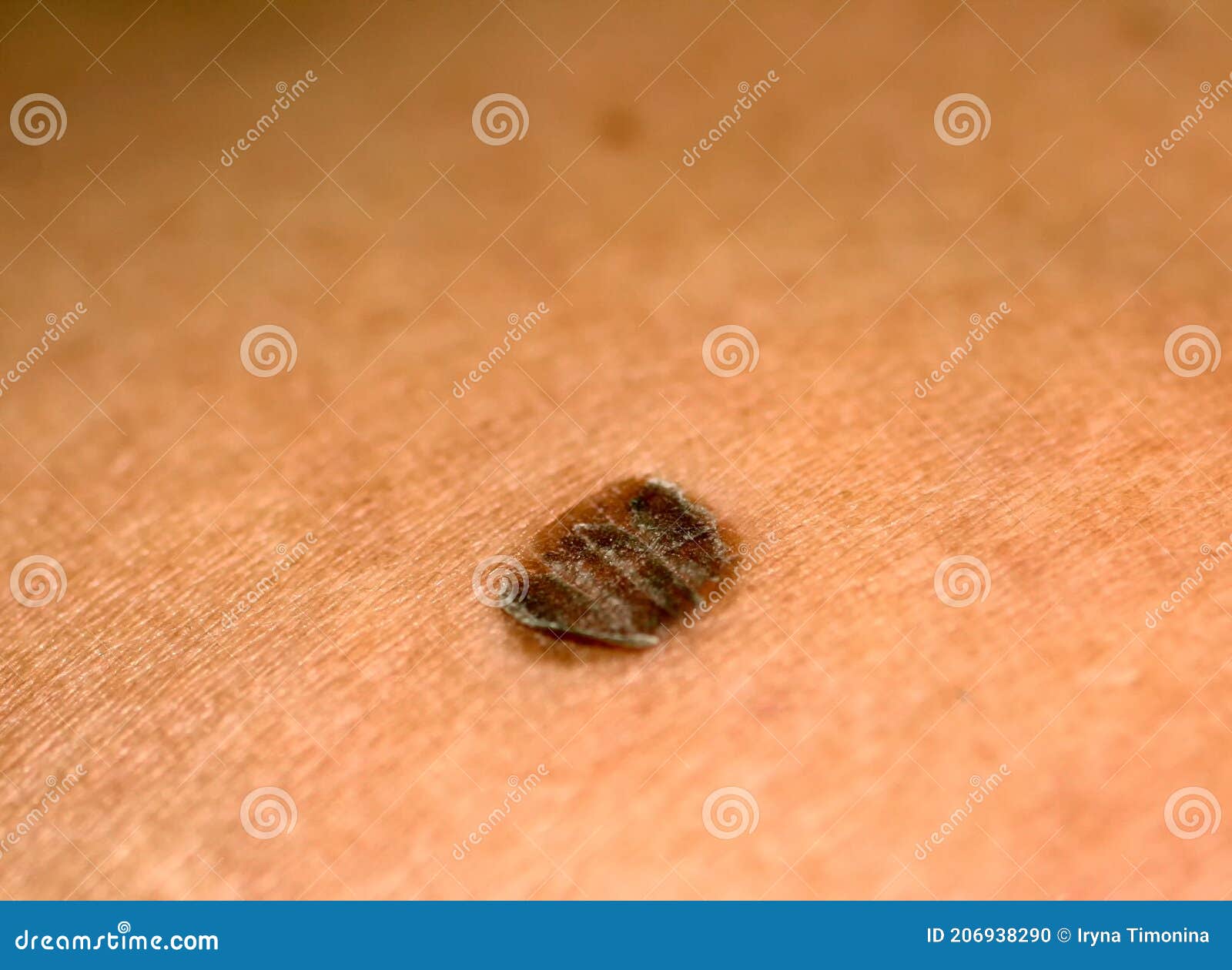 Brown Spot. Scaly, Flaky. Birthmark on Skin. Stock Photo - Image of ...