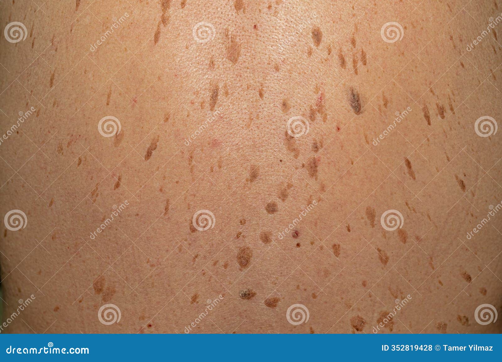 Brown Spots and Freckles on the Back of an Old Man. Skin Problems Stock ...