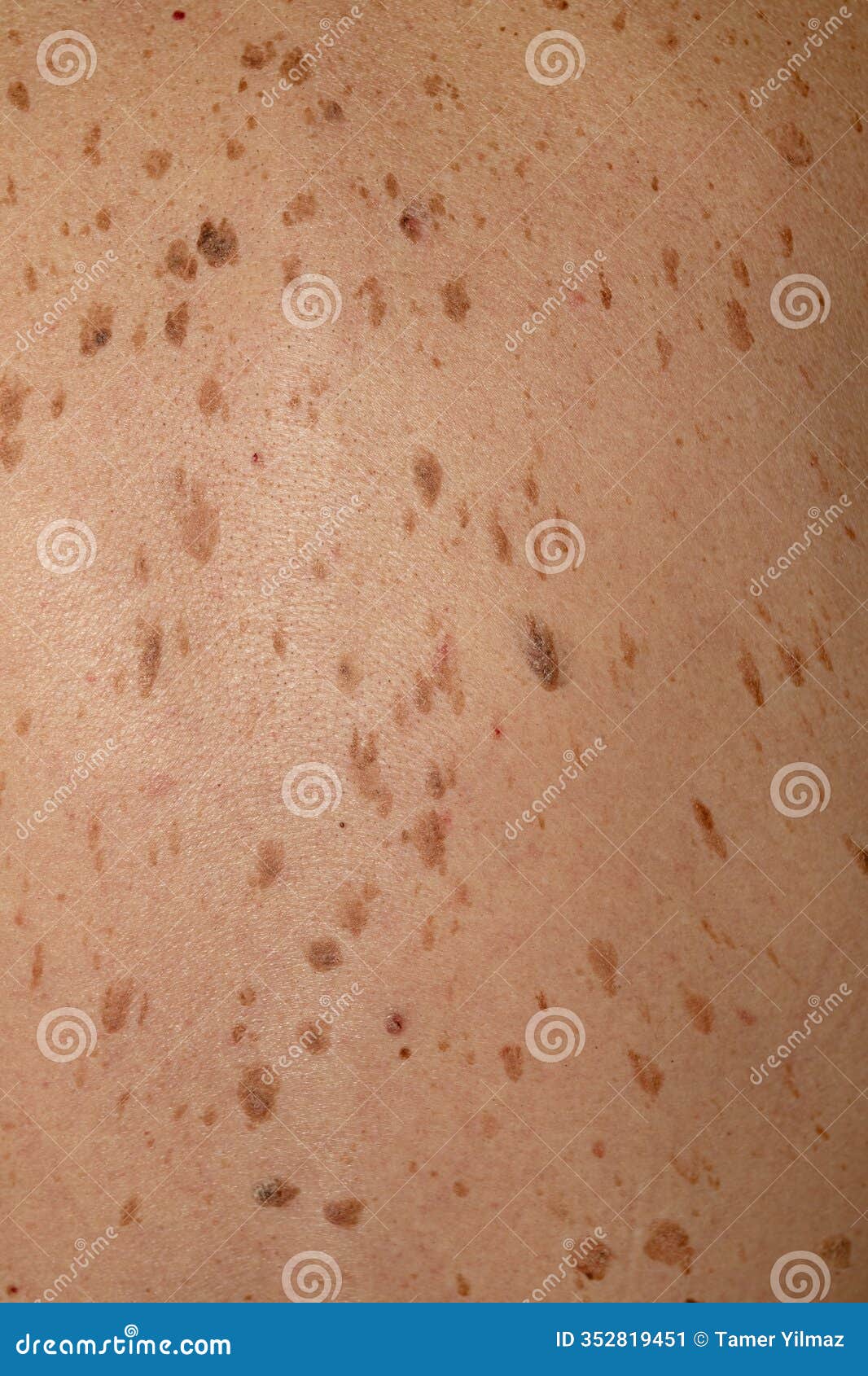 Brown Spots and Freckles on the Back of an Old Man. Skin Problems Stock ...
