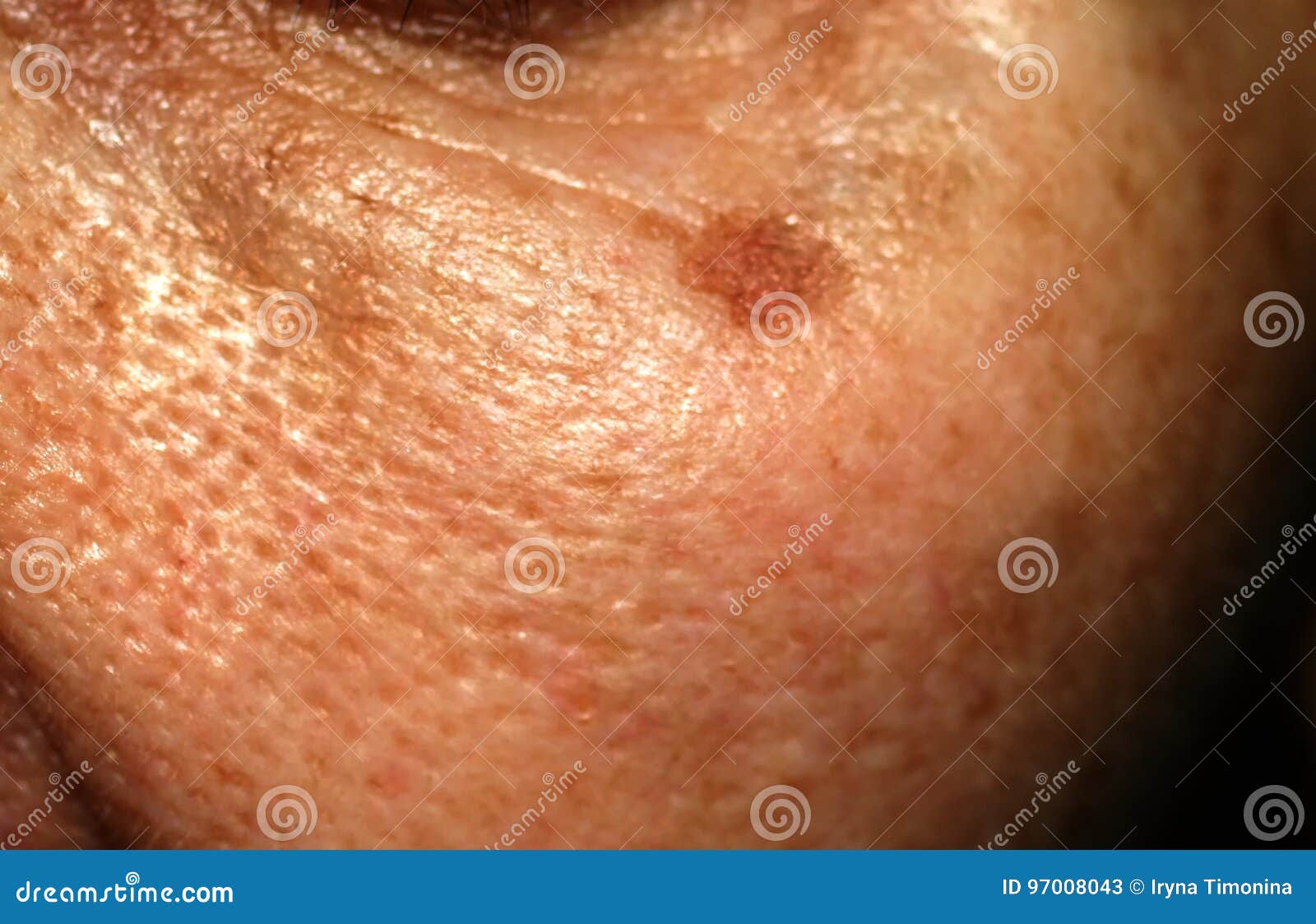Brown Stain on the Face. Pigmentation on the Skin Stock Image - Image ...