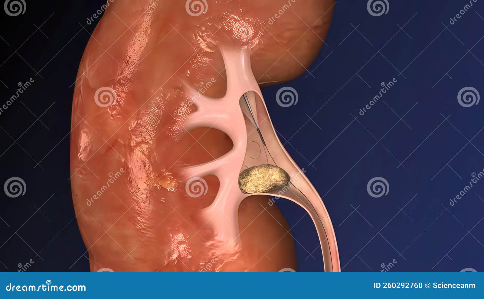 Broyage De Pierre Dans Le Rein Illustration Stock - Illustration du ...