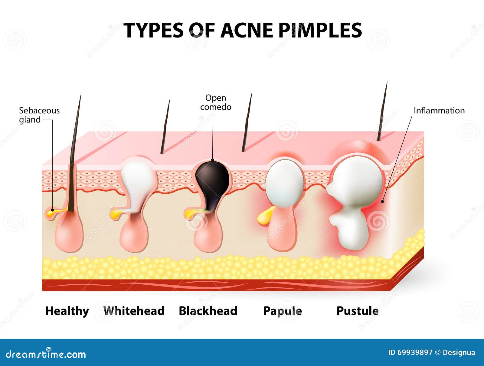 Brufoli dell'acne illustrazione vettoriale. Illustrazione di medicina ...