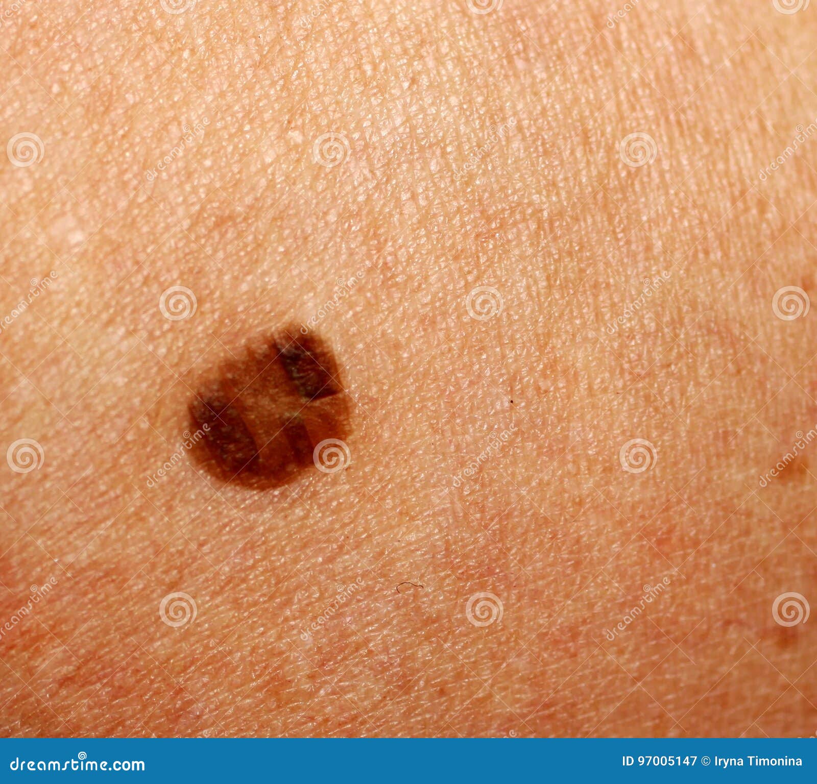 Bruine Vlek Op De Huid Moedervlek Op Het Lichaam Stock Afbeelding ...
