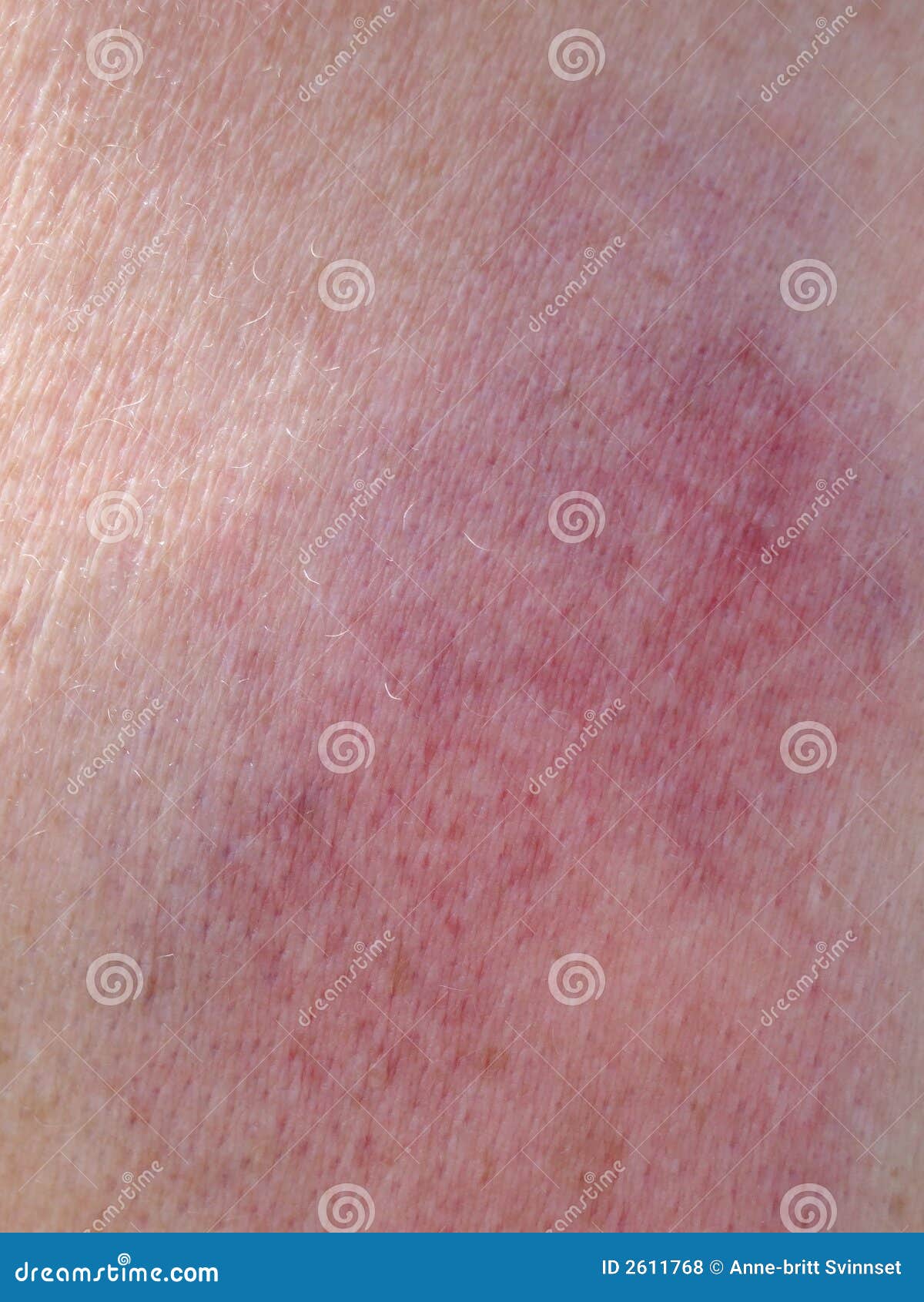 Bruise stock photo. Image of closeup, bruise, injury, accident - 2611768